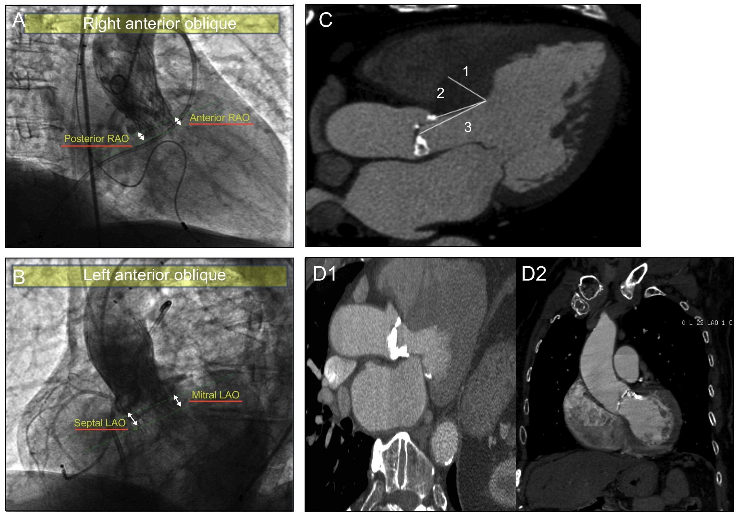 Atrioventricular Conduction Changes After CoreValve Transcatheter ...