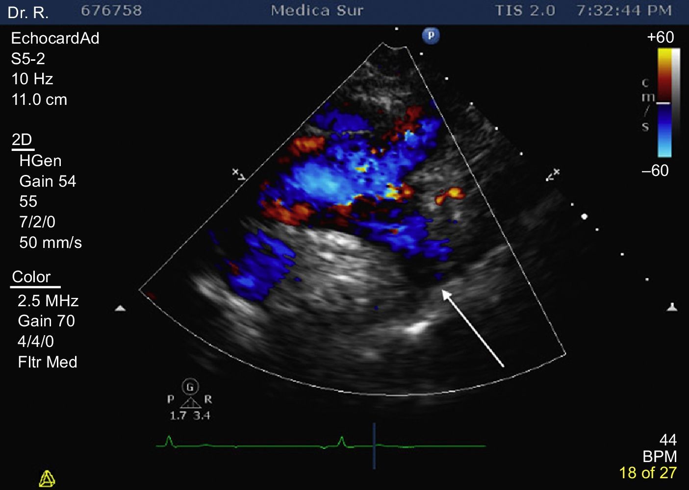 Interrupted Aortic Arch in an Adult and Myocardial Infarction | Revista ...