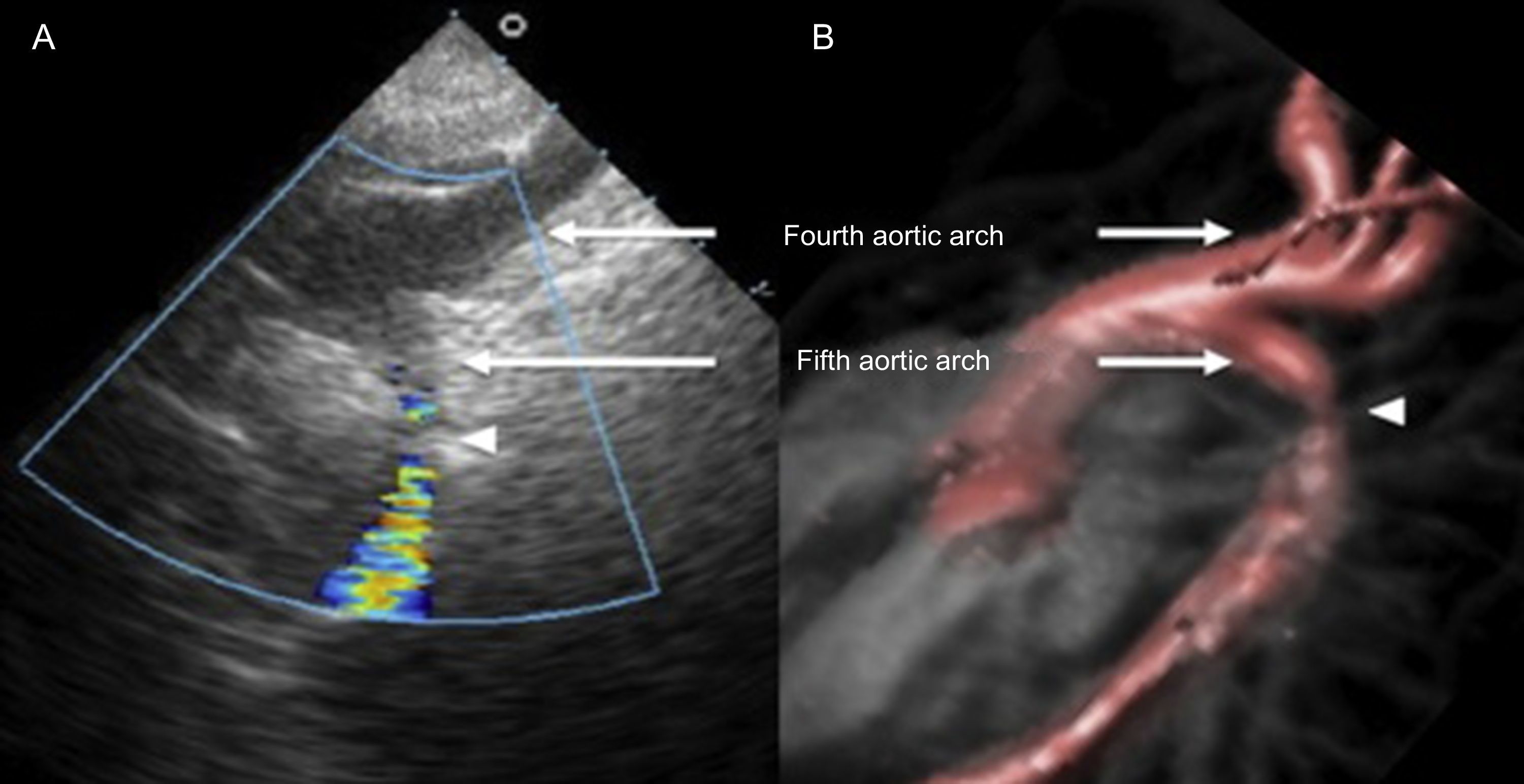 Coarctation of Persistent Fifth Aortic Arch With Interrupted Fourth ...
