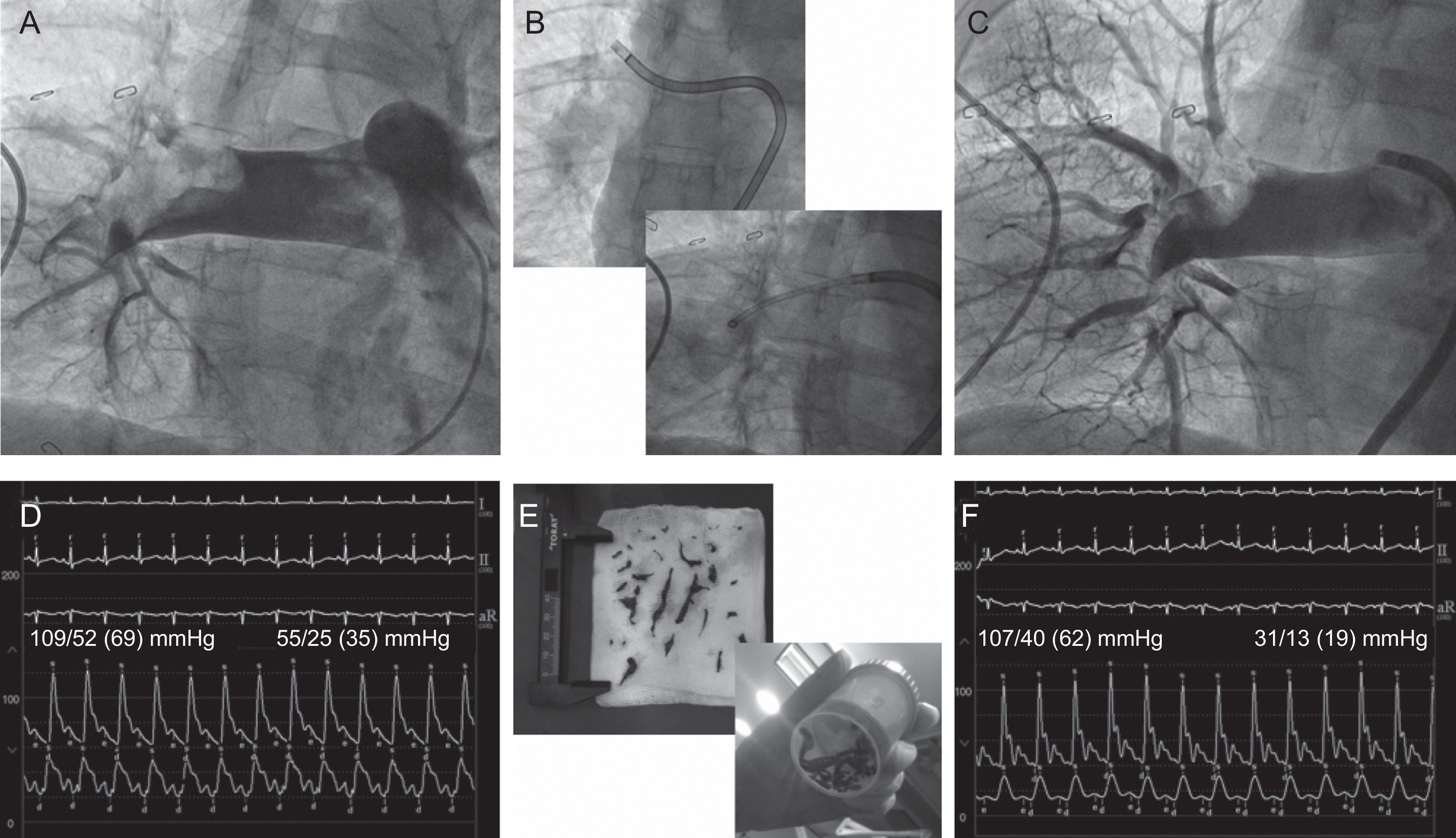Percutaneous Transcatheter Treatment for Massive Pulmonary Embolism ...