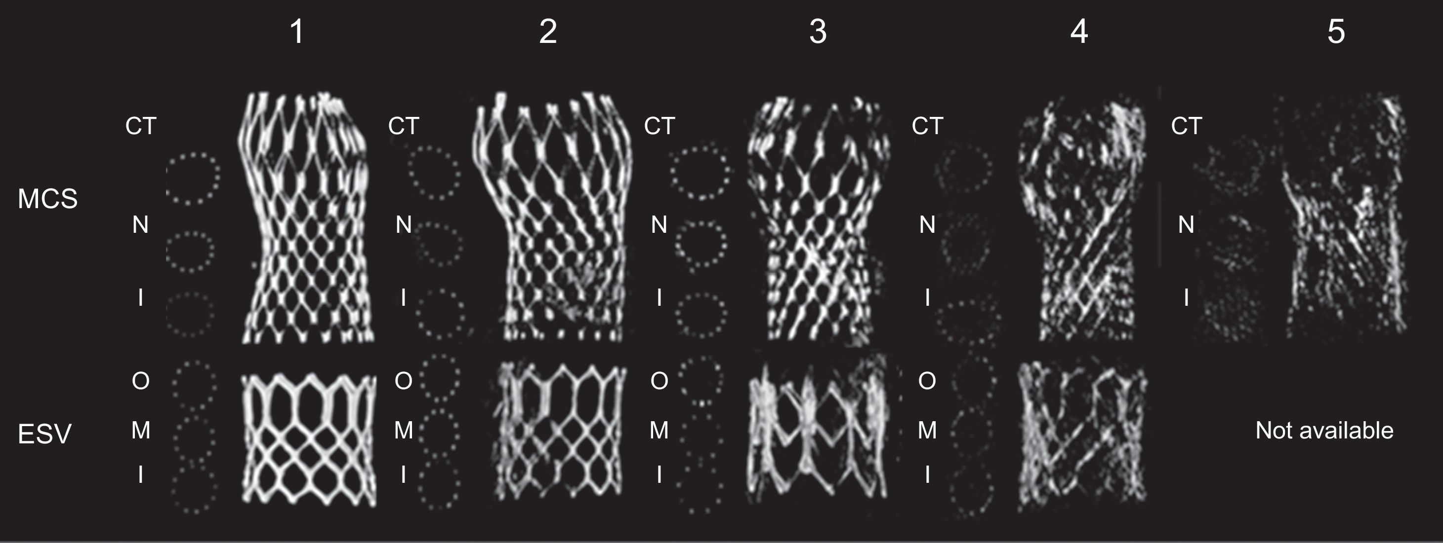Differences in Frame Geometry Between Balloon-expandable and Self ...