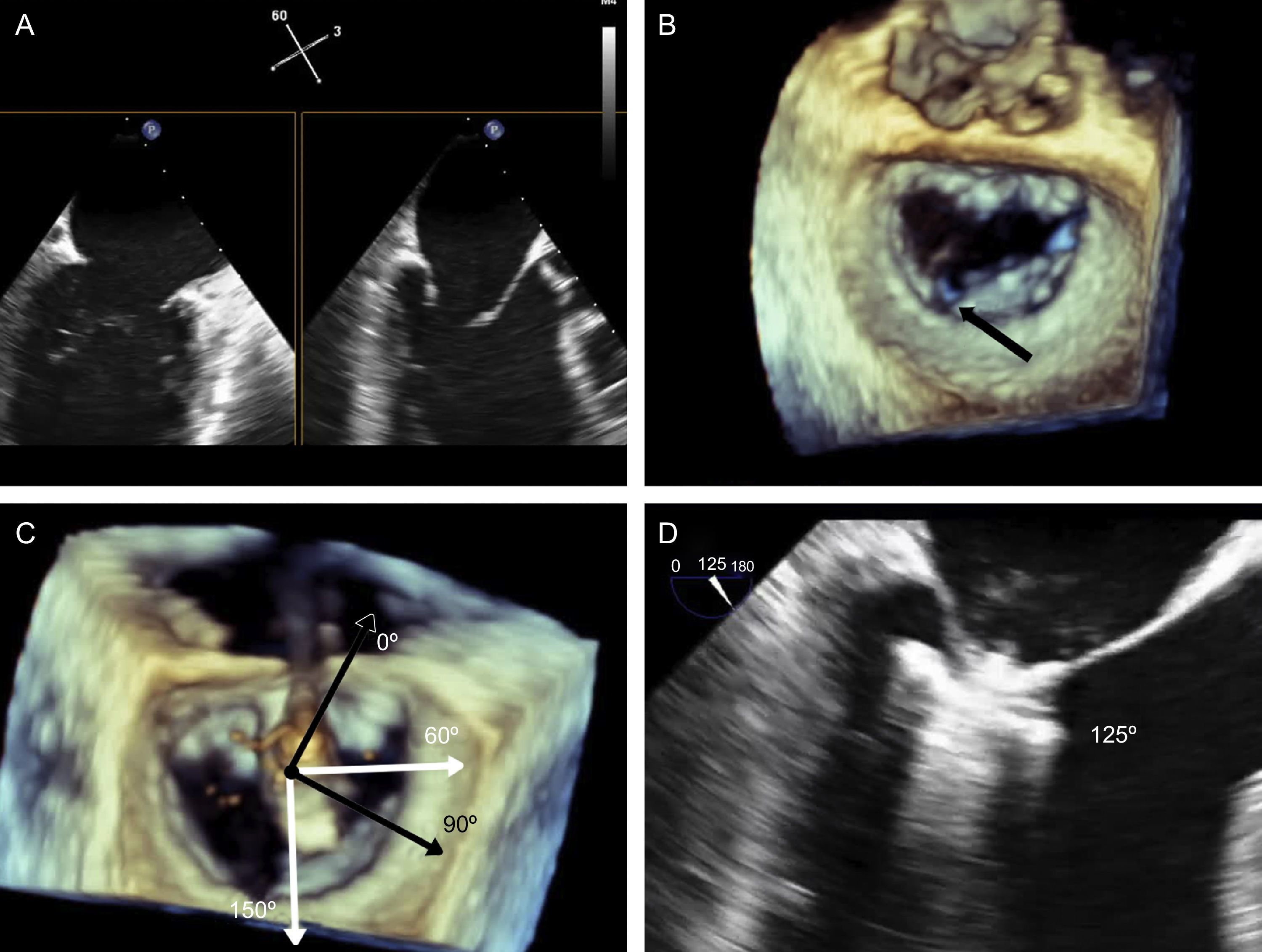 Role of Imaging Techniques in Percutaneous Treatment of Mitral ...