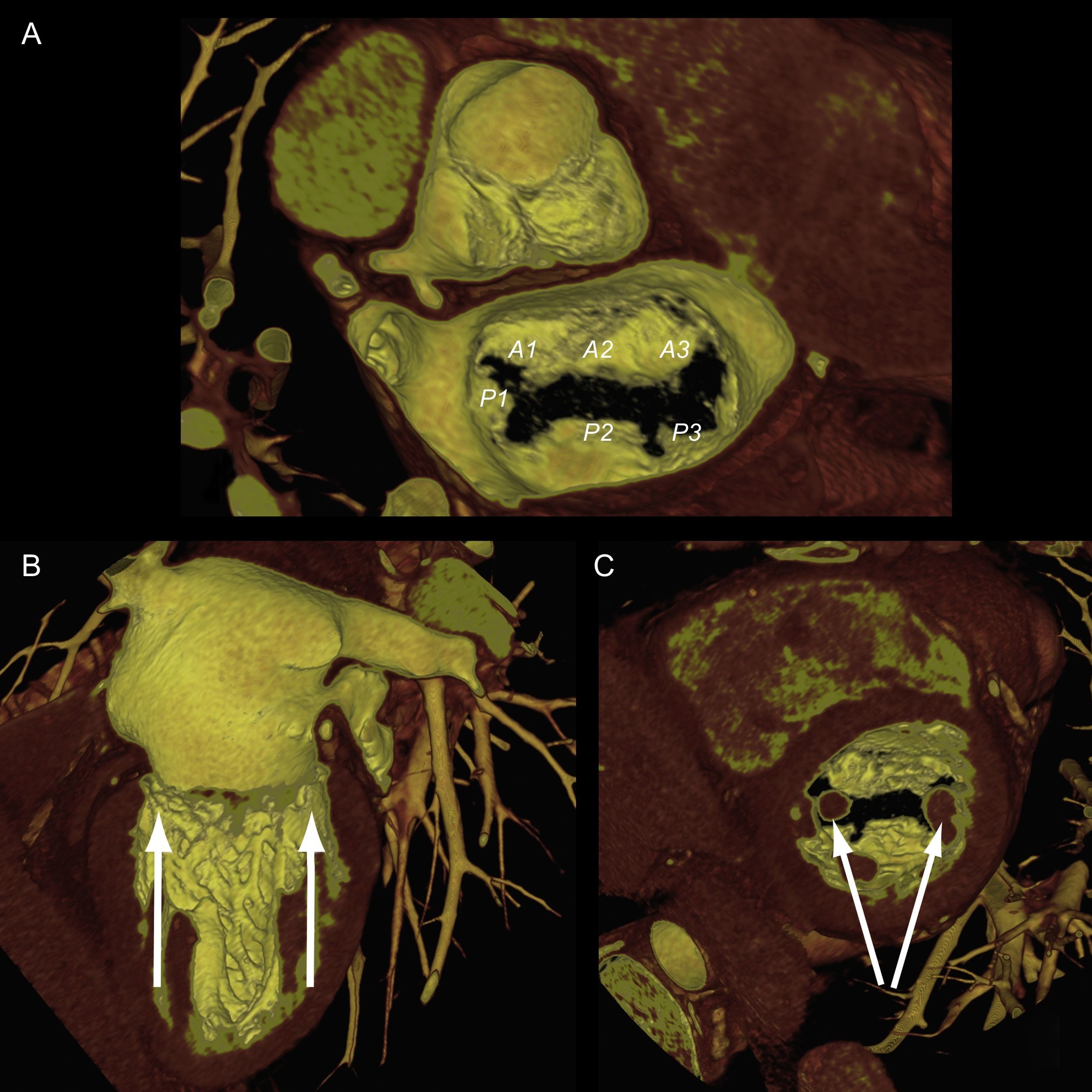 Role of Imaging Techniques in Percutaneous Treatment of Mitral ...