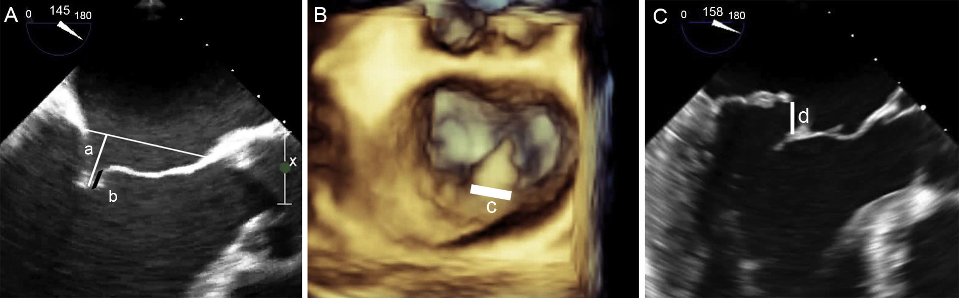 Role of Imaging Techniques in Percutaneous Treatment of Mitral ...