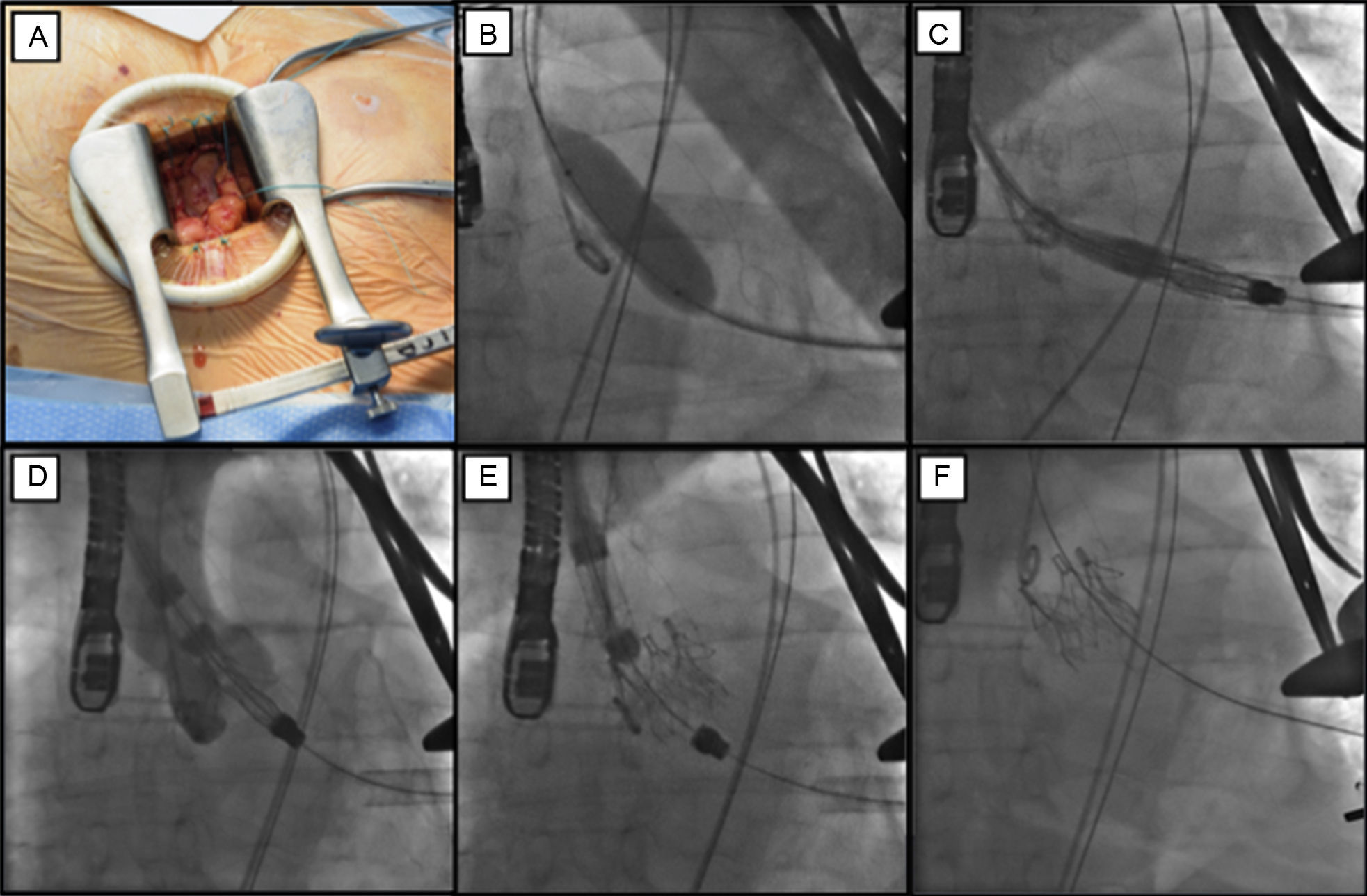 Transapical Implantation in the Catheterization Laboratory of the ...