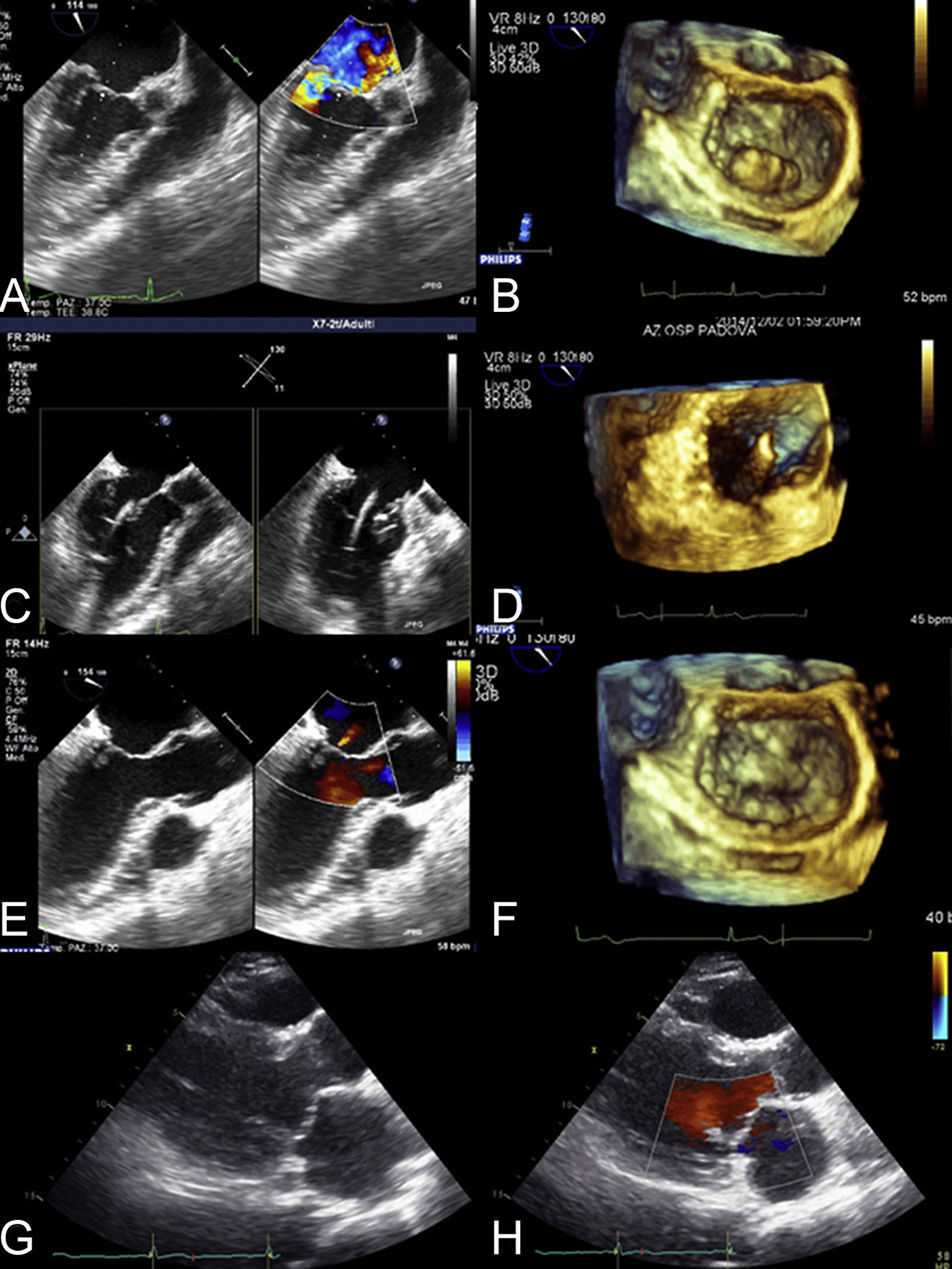 Transapical Off-pump Neochord Implantation for Mitral Regurgitation ...