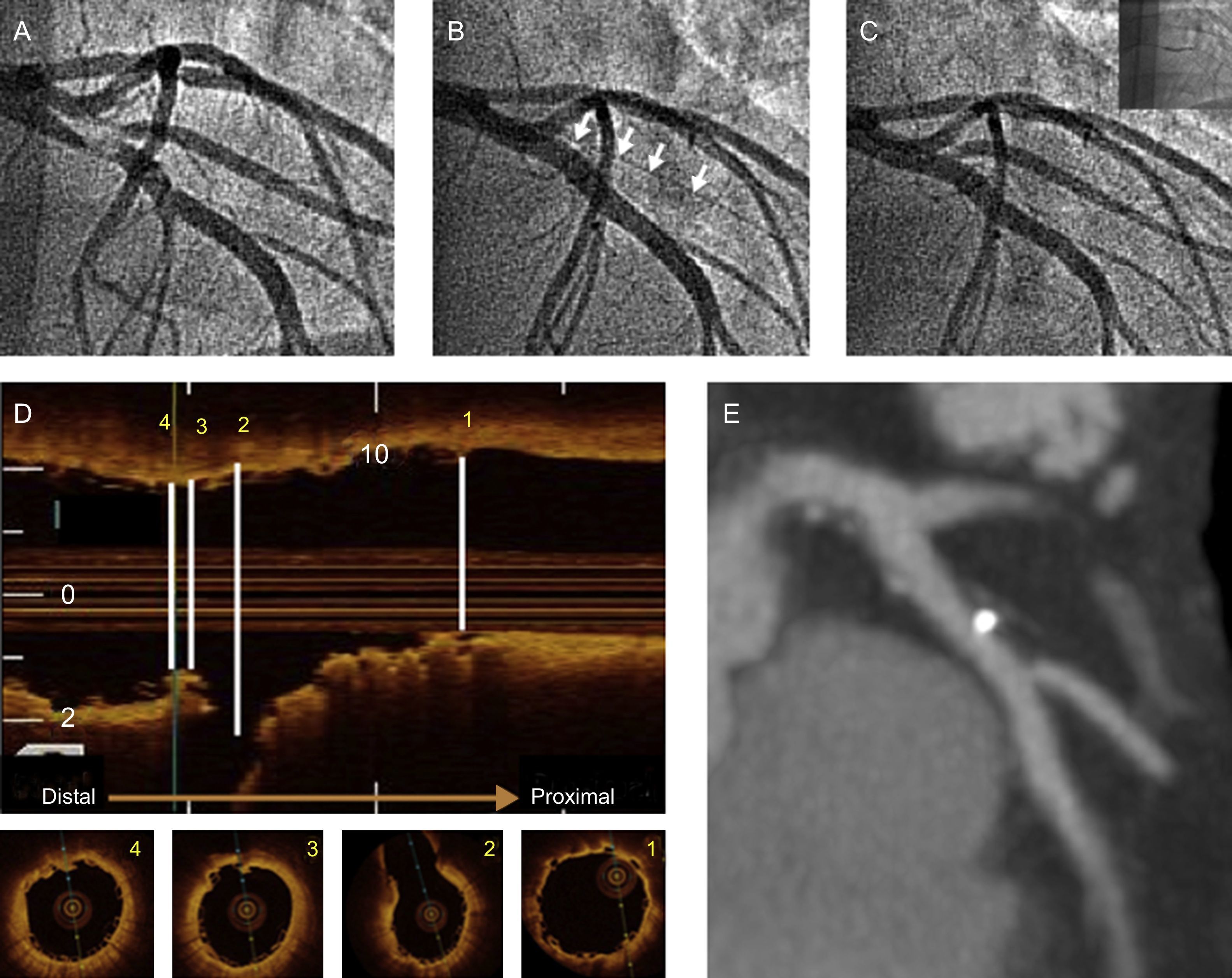Bioresorbable Vascular Scaffold for the Treatment of Coronary ...