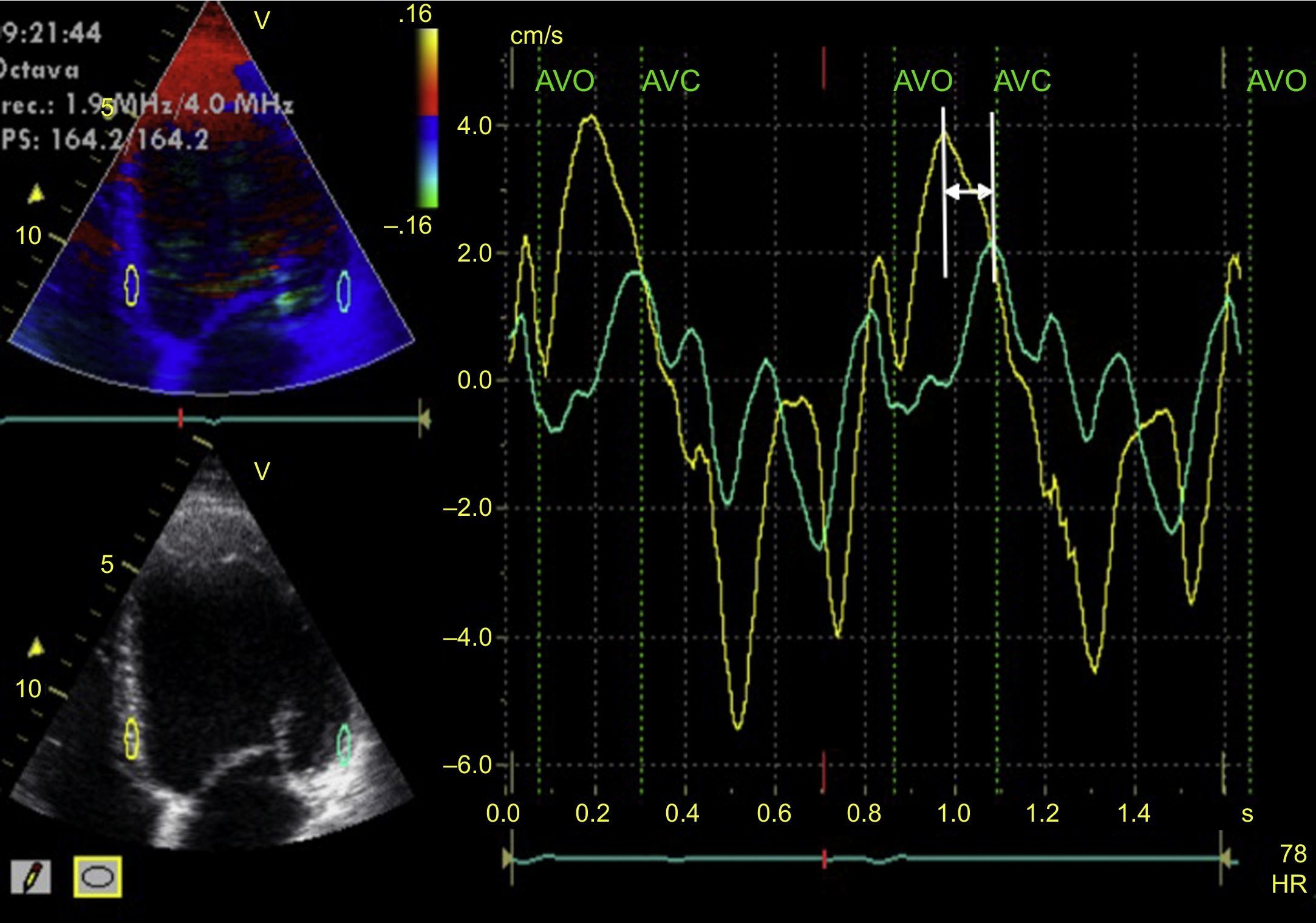 Cardiovascular Imaging in the Electrophysiology Laboratory | Revista ...