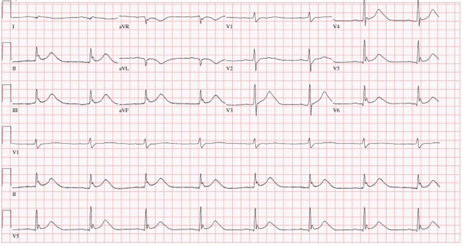 Intermittent Brugada Pattern in Relation to Changes in Body Temperature ...