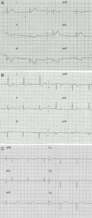 Usefulness of Reciprocal Changes in the Diagnosis of Myocardial ...
