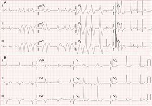 Changes in Conduction Properties of Accessory Pathways: From ...