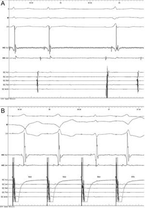 Changes in Conduction Properties of Accessory Pathways: From ...