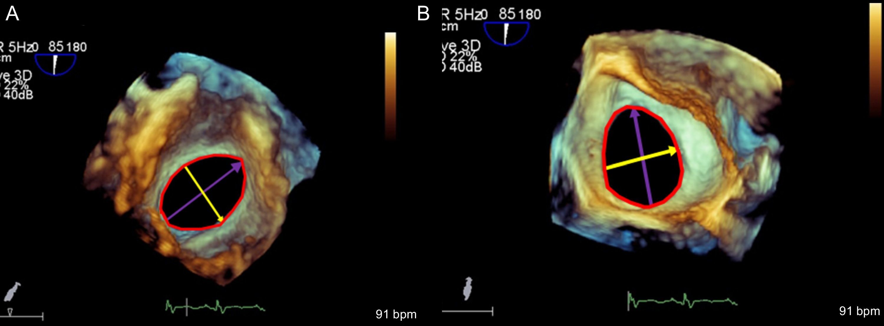 Imaging Techniques in Percutaneous Cardiac Structural Interventions ...