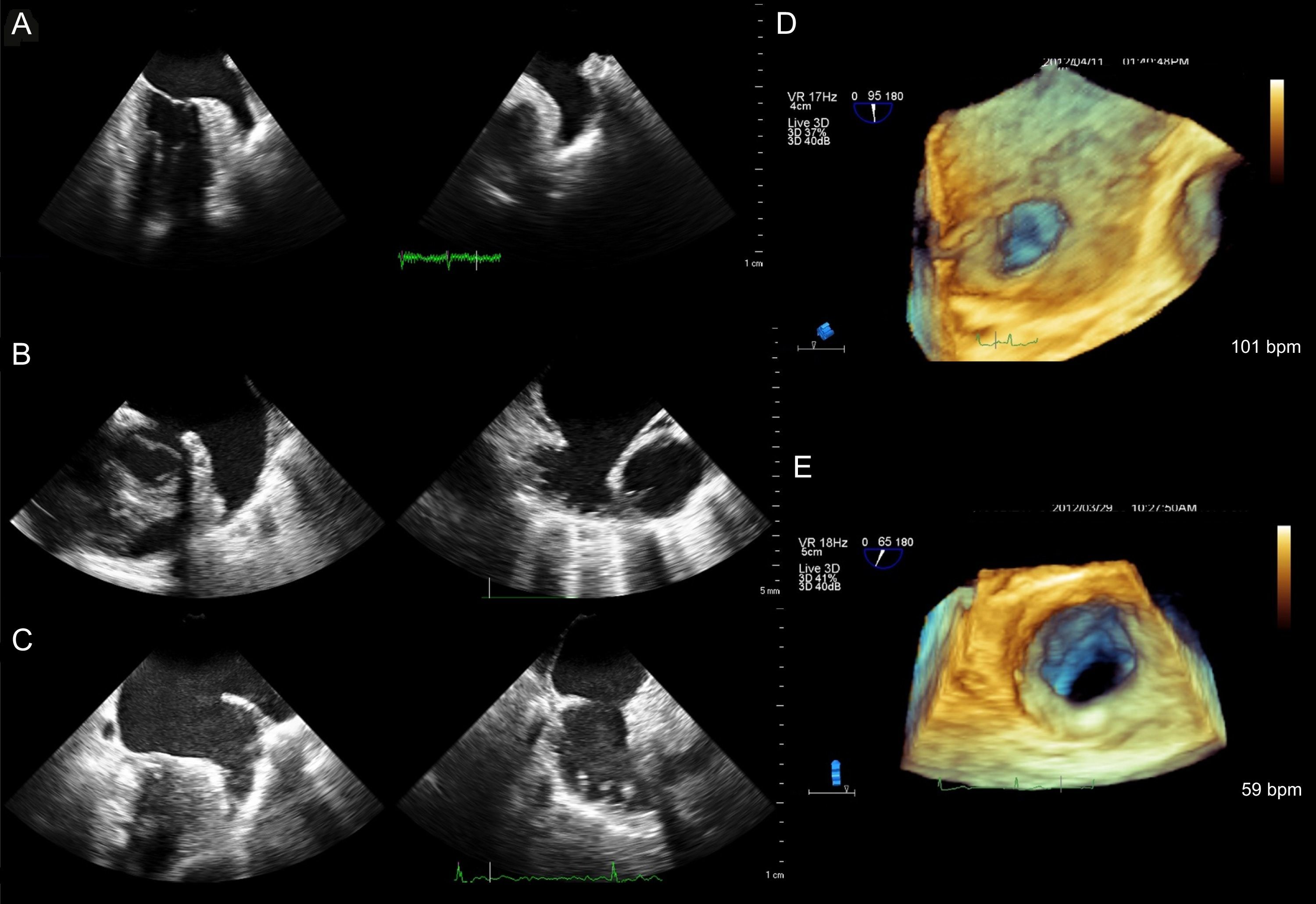 Imaging Techniques in Percutaneous Cardiac Structural Interventions ...