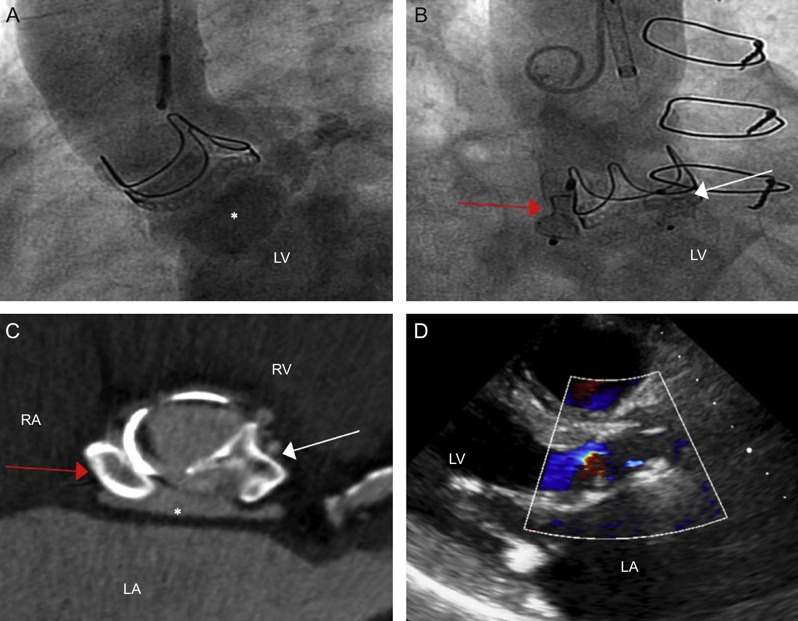 Percutaneous Closure of Fistula Secondary to Infective Endocarditis ...