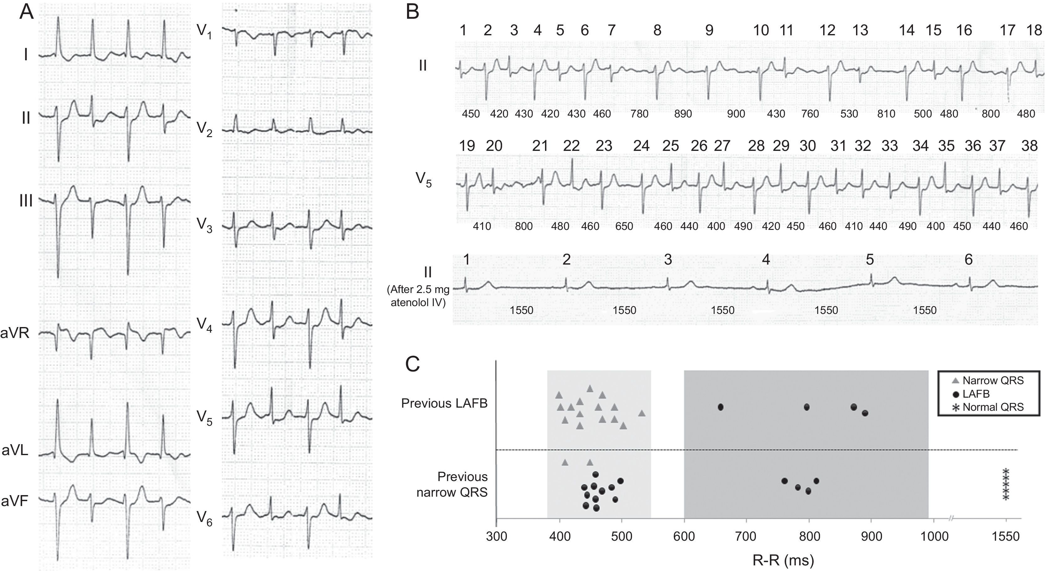 lafb ecg changes