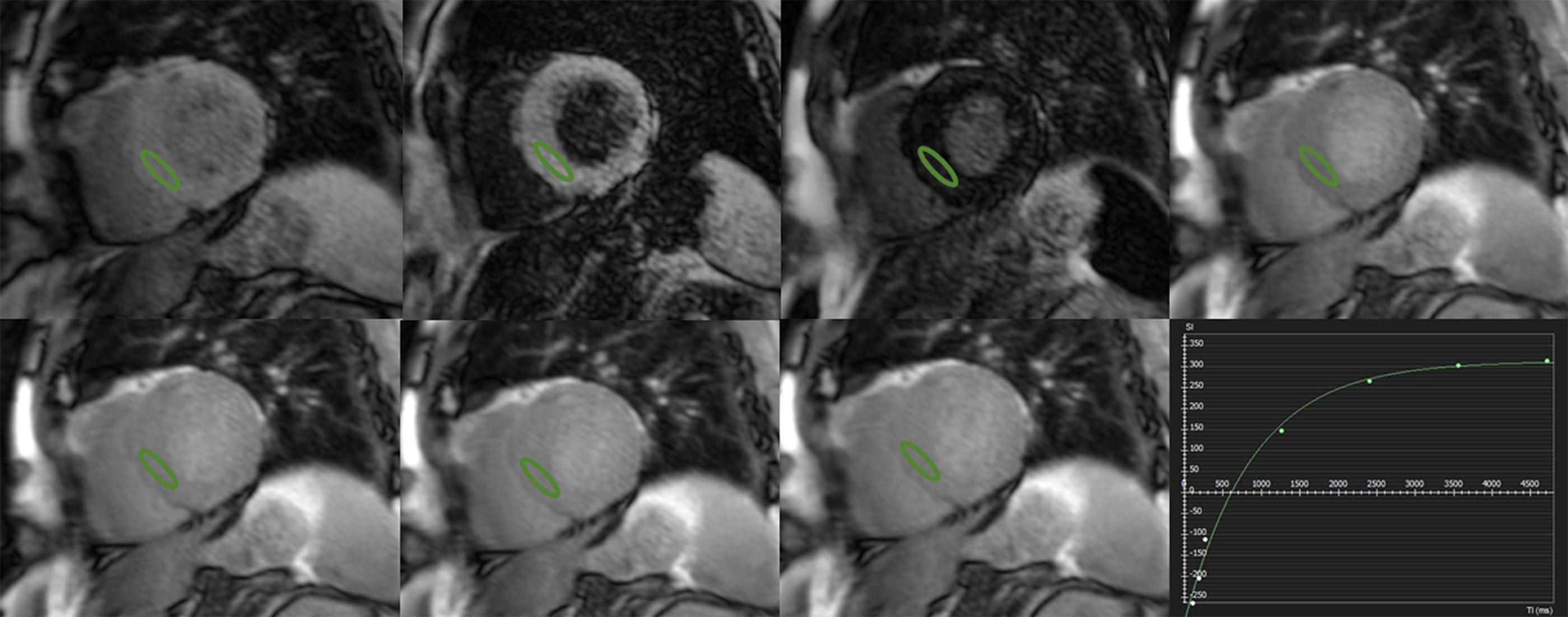Myocardial Mapping With Cardiac Magnetic Resonance: The Diagnostic ...