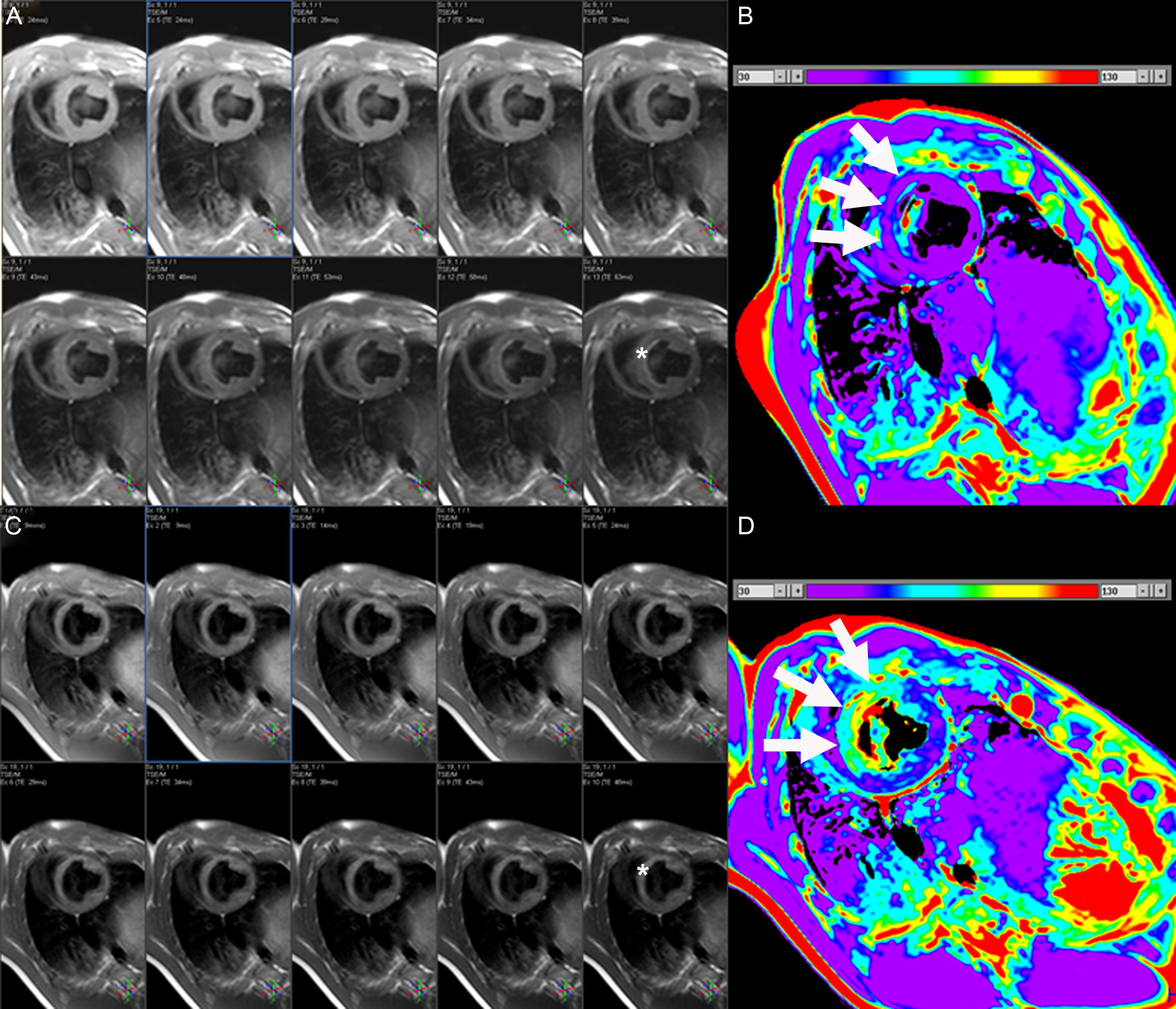Myocardial Mapping With Cardiac Magnetic Resonance: The Diagnostic ...