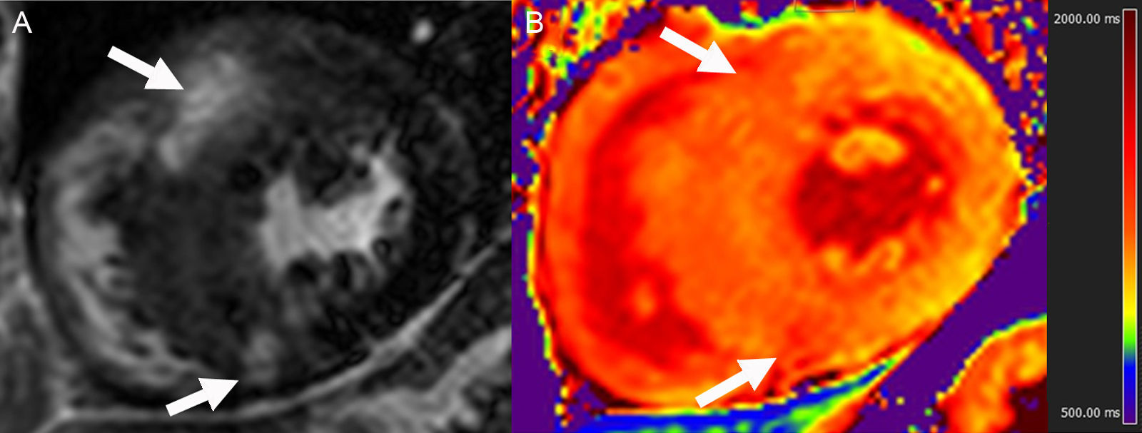 Myocardial Mapping With Cardiac Magnetic Resonance: The Diagnostic ...
