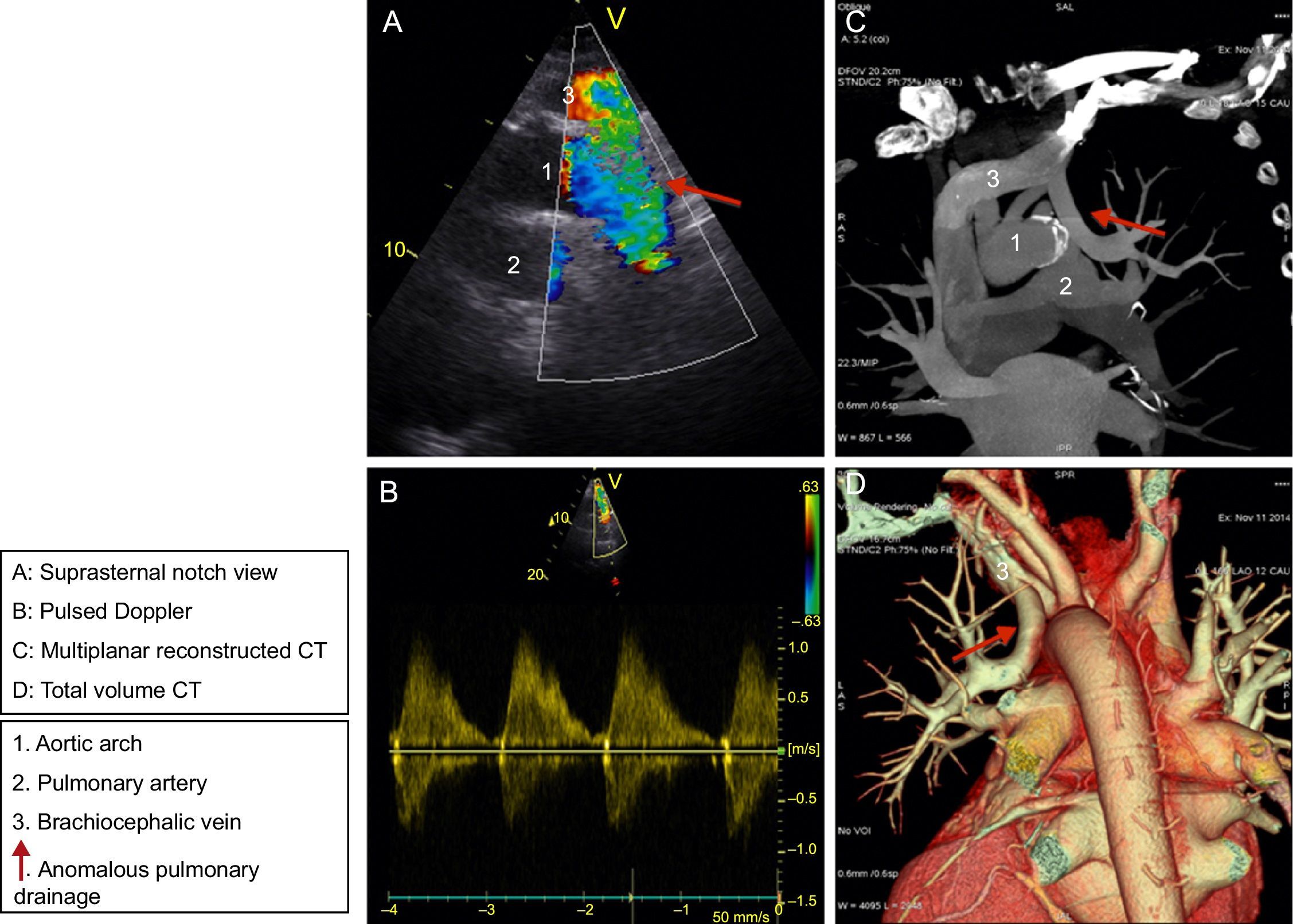 Suprasternal Notch View and Anomalous Pulmonary Drainage | Revista ...