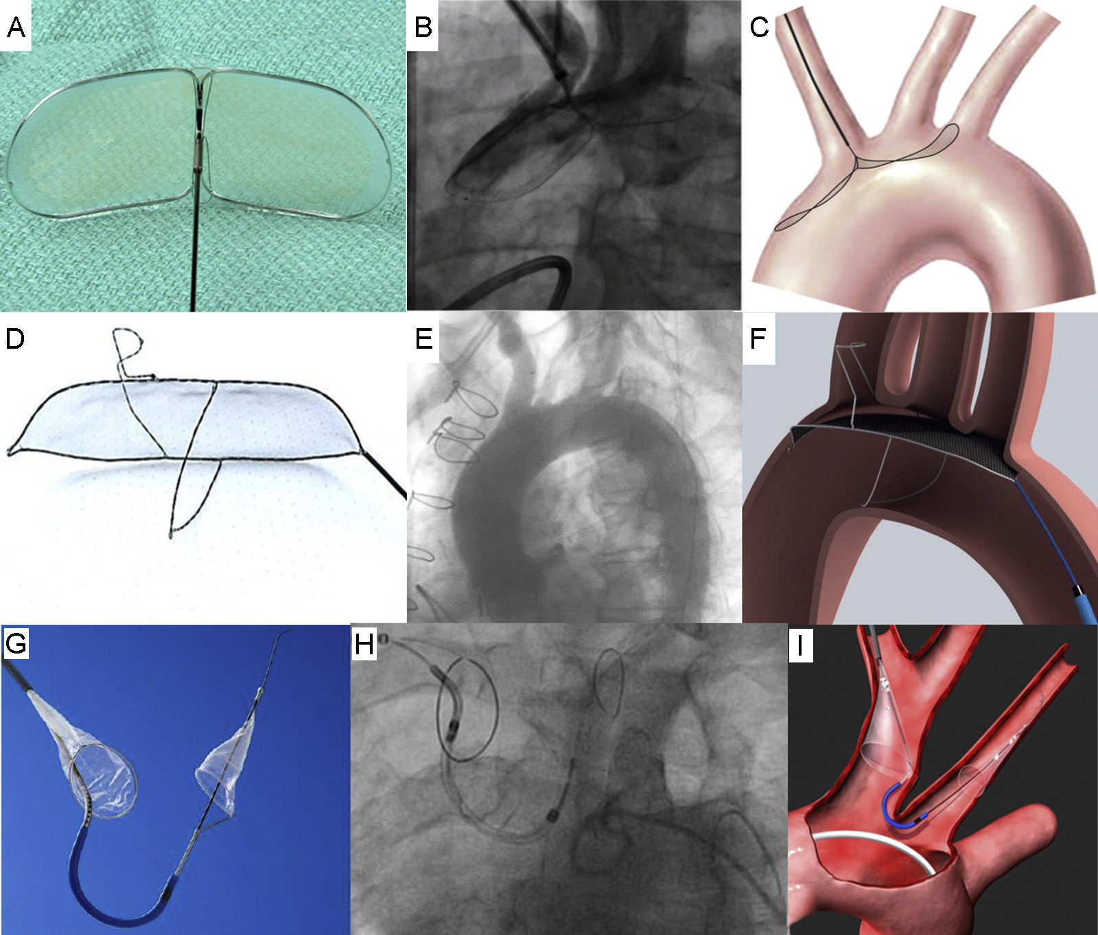 Embolic Protection Devices During TAVI: Current Evidence and Uncertainties