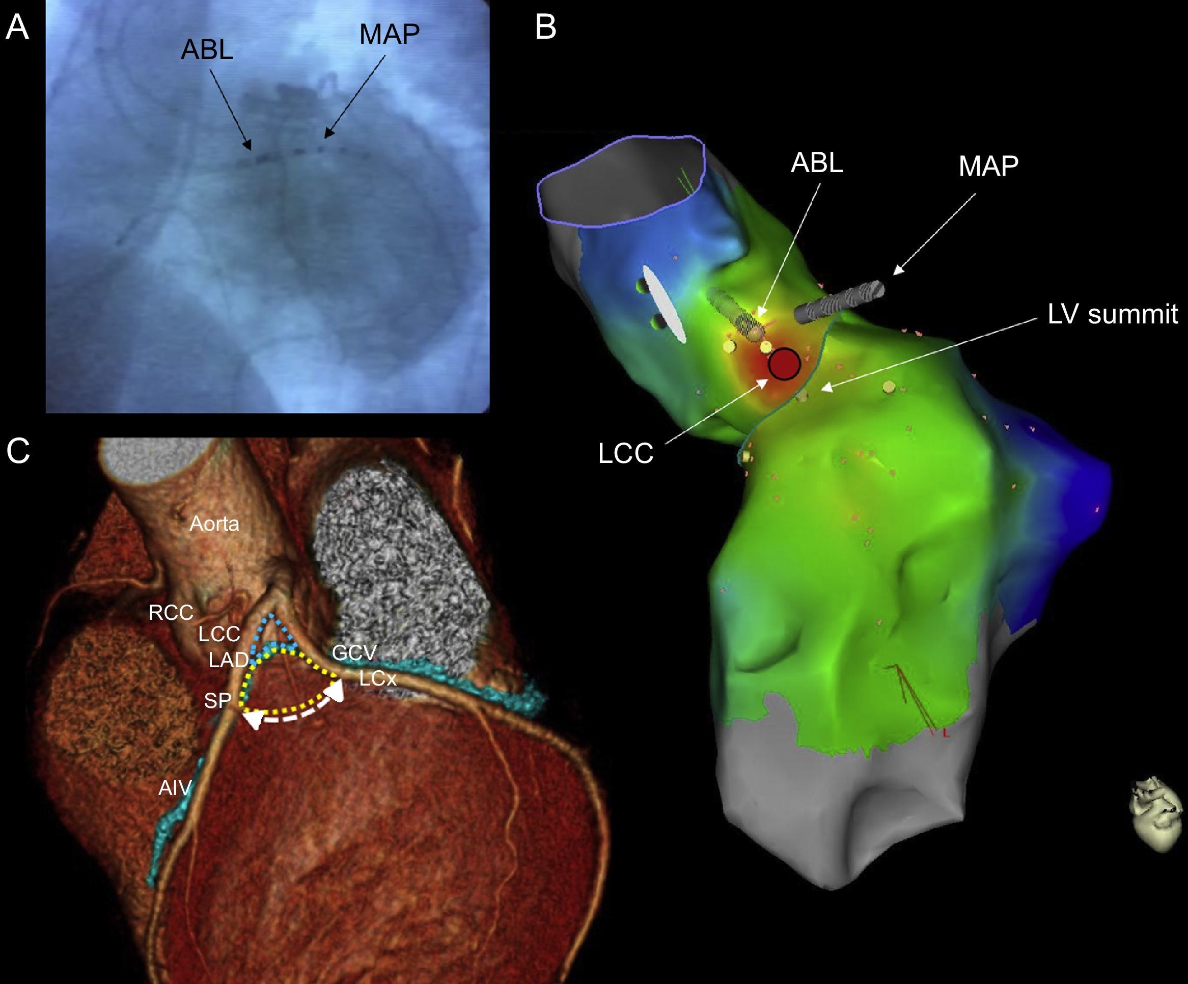 Catheter Ablation Of Premature Ventricular Contractions From The Left
