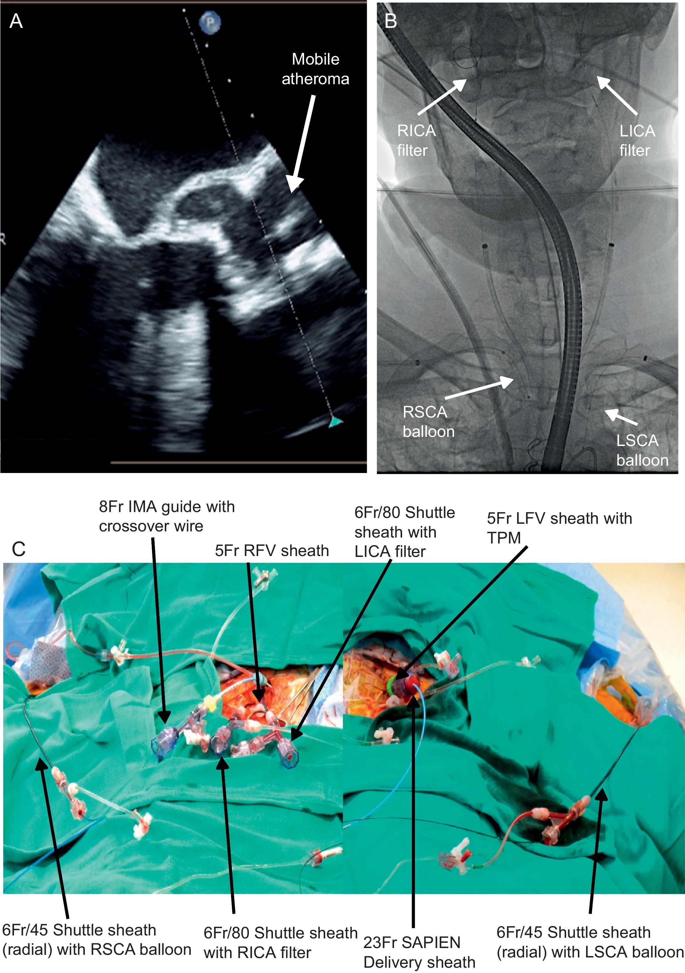 Should Embolic Protection Become the Standard of Care for Stroke ...