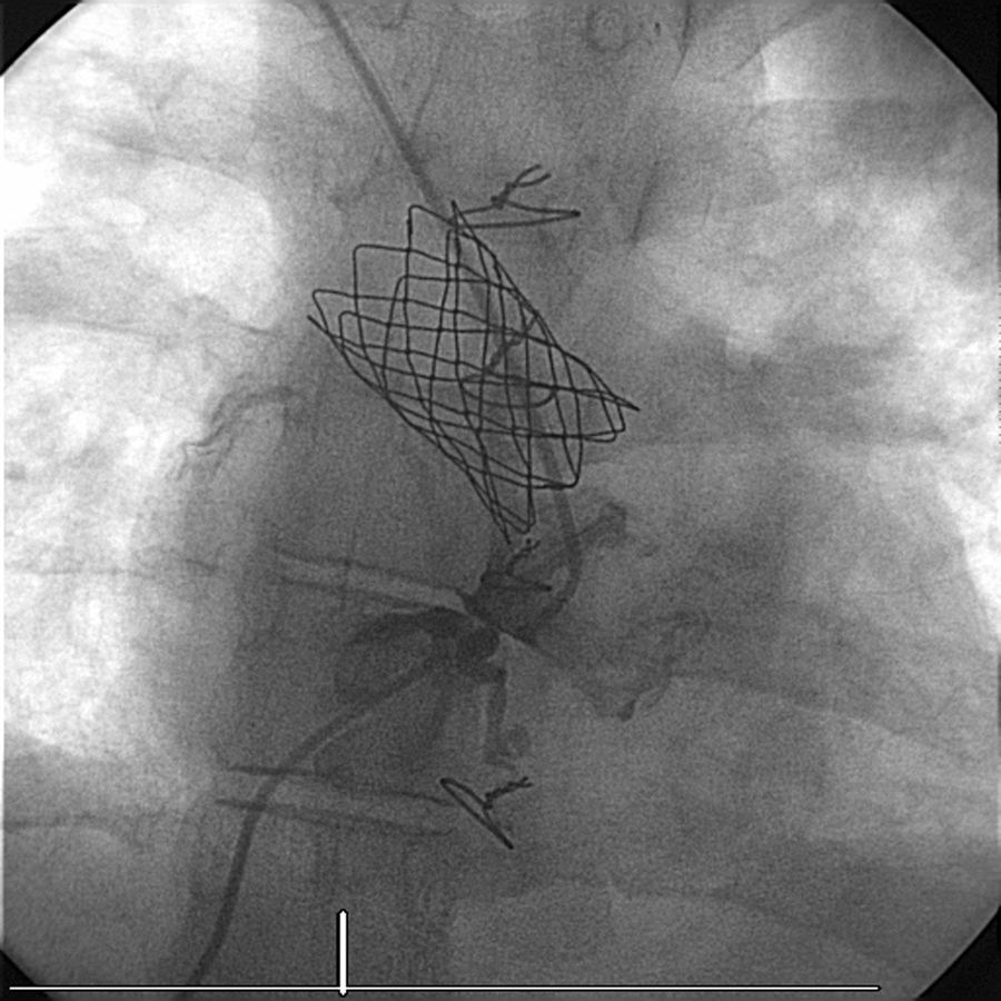 Percutaneous Recanalization of Complete Inferior Vena Cava Occlusion in ...