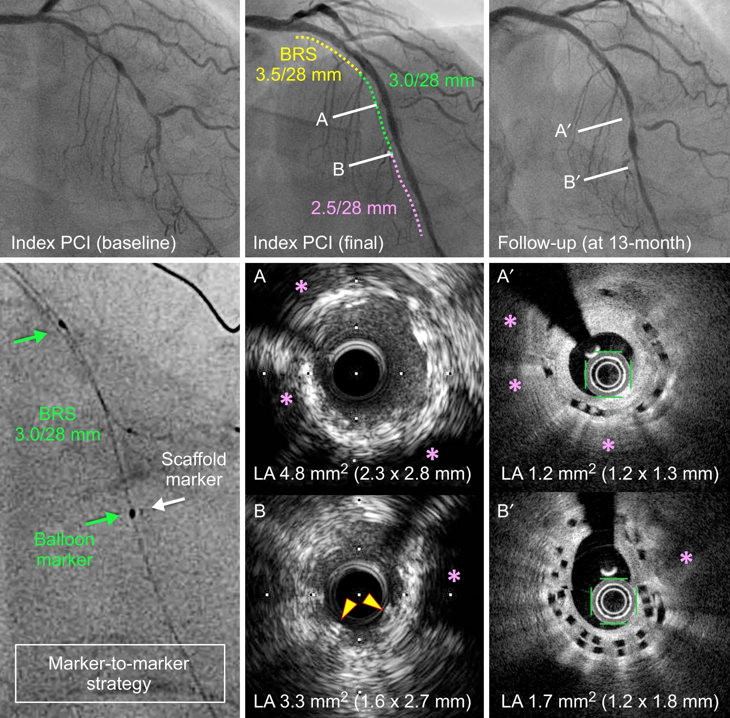 Clinical Outcomes After Implantation of Overlapping Bioresorbable ...