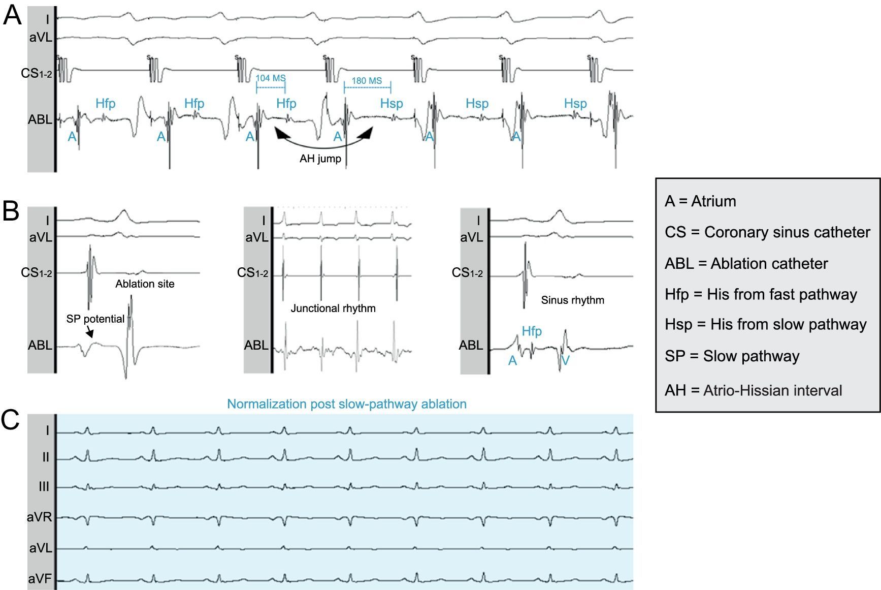 Manifest and Concealed Atrioventricular Nodal Double Firing | Revista ...