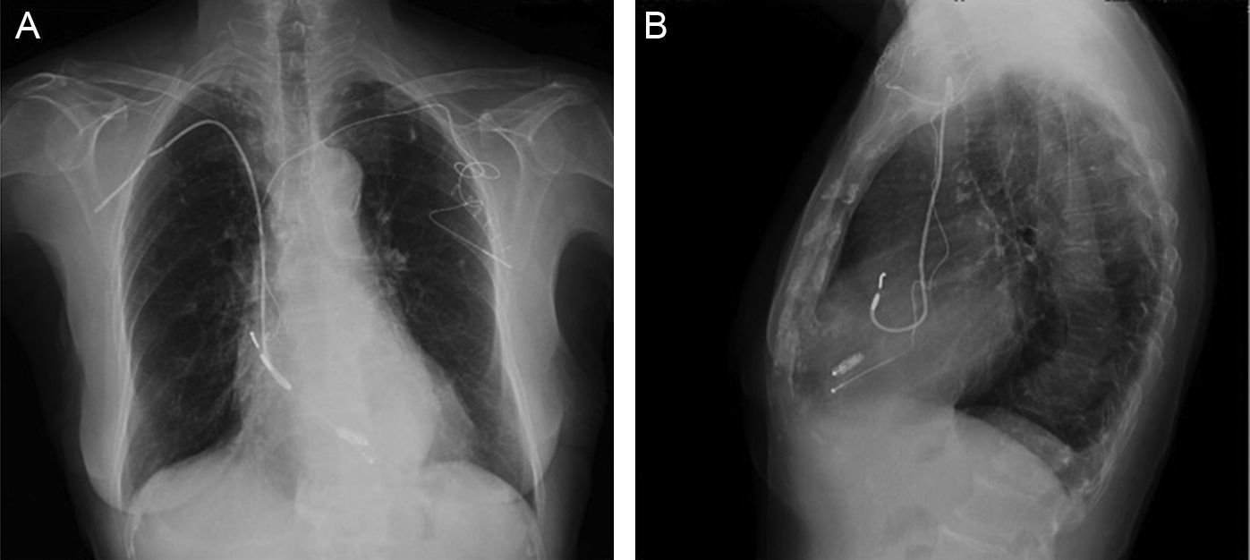 Leadless Pacemaker Due to Bilateral Subclavian Stenosis | Revista ...