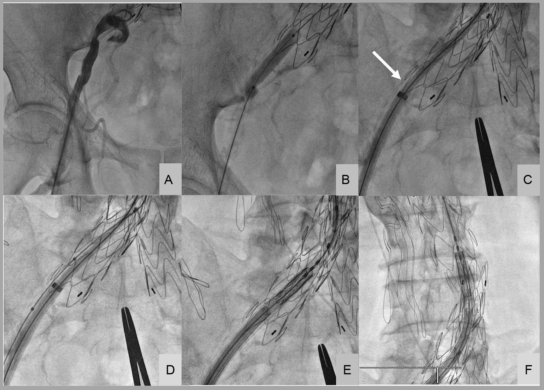 Transcatheter Aortic Valve Implantation in Patients With Arterial ...