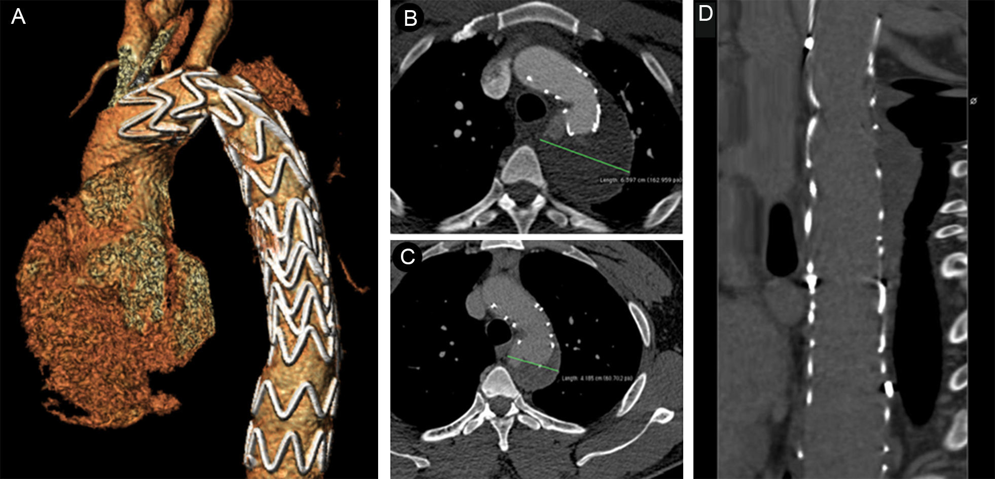 Endovascular Treatment of a Complicated Acute Type B Aortic Dissection ...