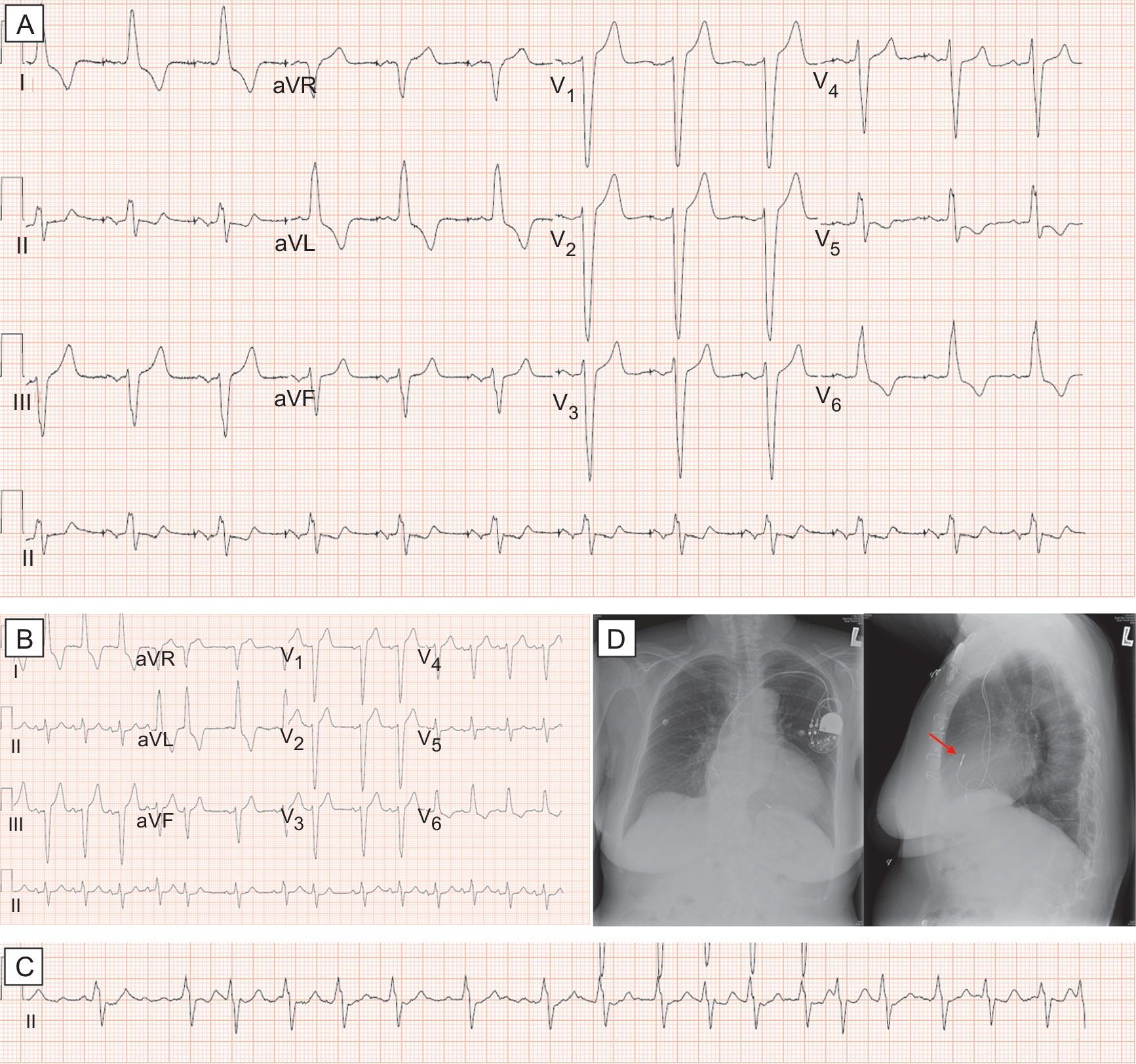 Paced Interatrial Block in Bayés’ Syndrome | Revista Española de ...
