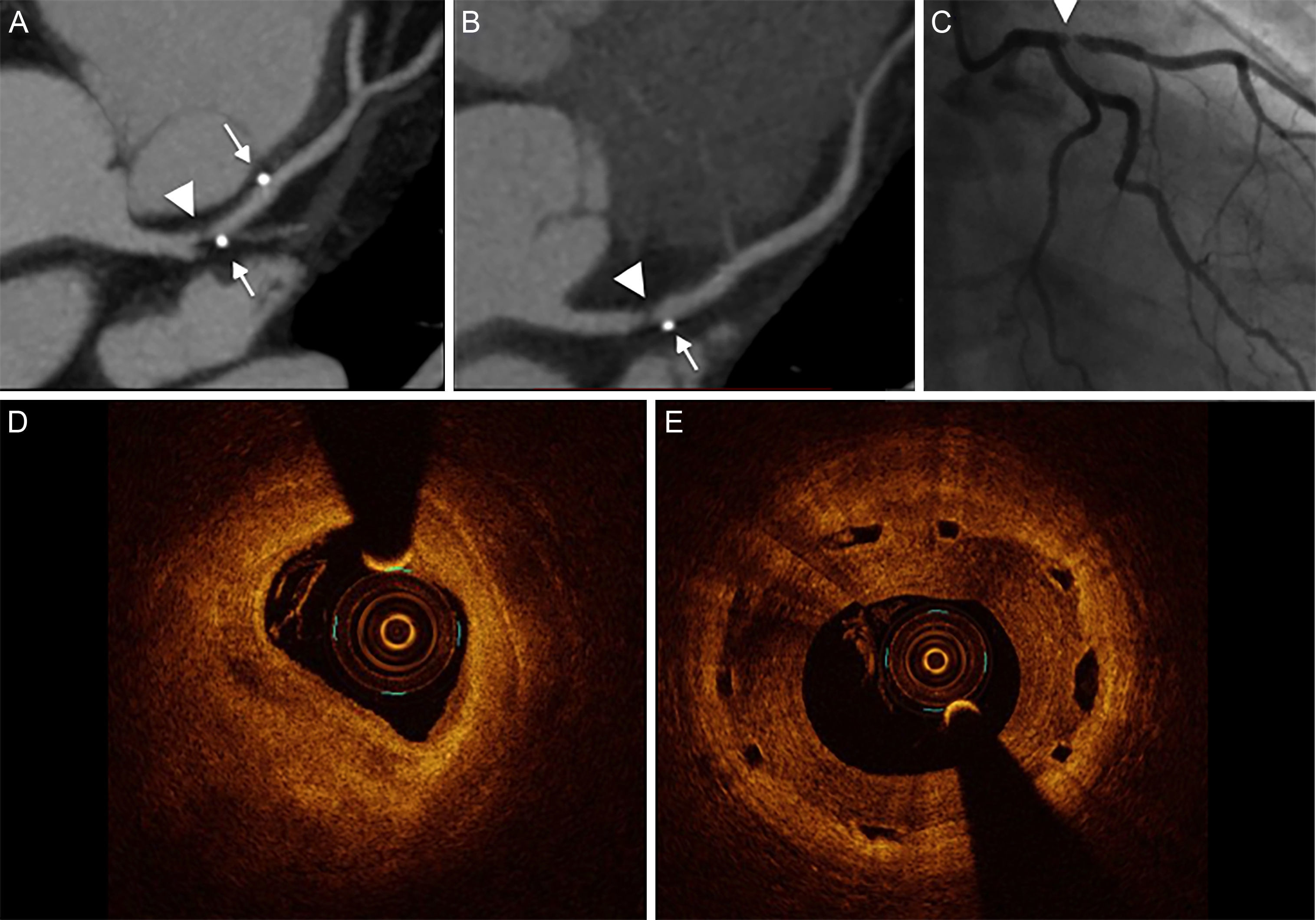 Restenosis After Everolimus-eluting Vascular Scaffolding. Angiographic ...