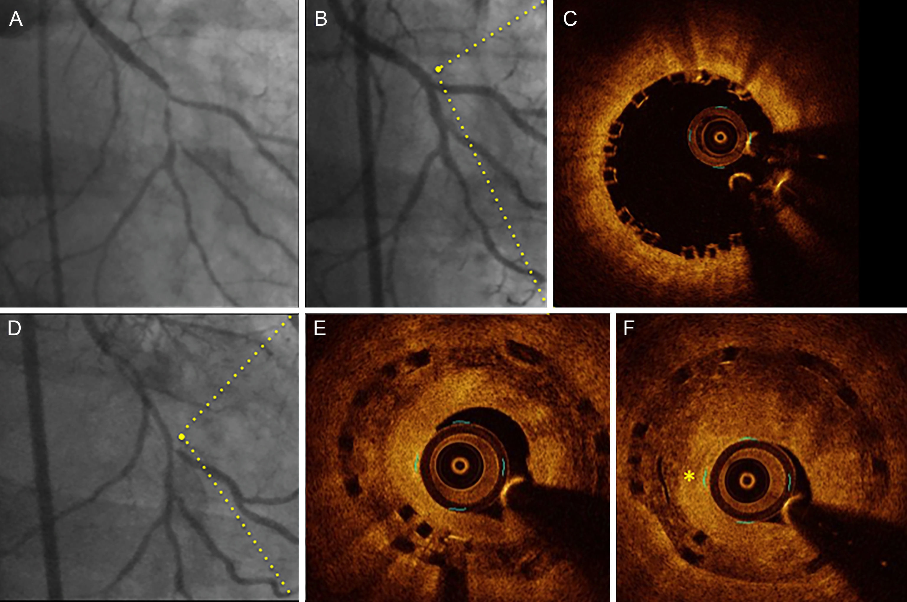 Restenosis After Everolimus-eluting Vascular Scaffolding. Angiographic ...