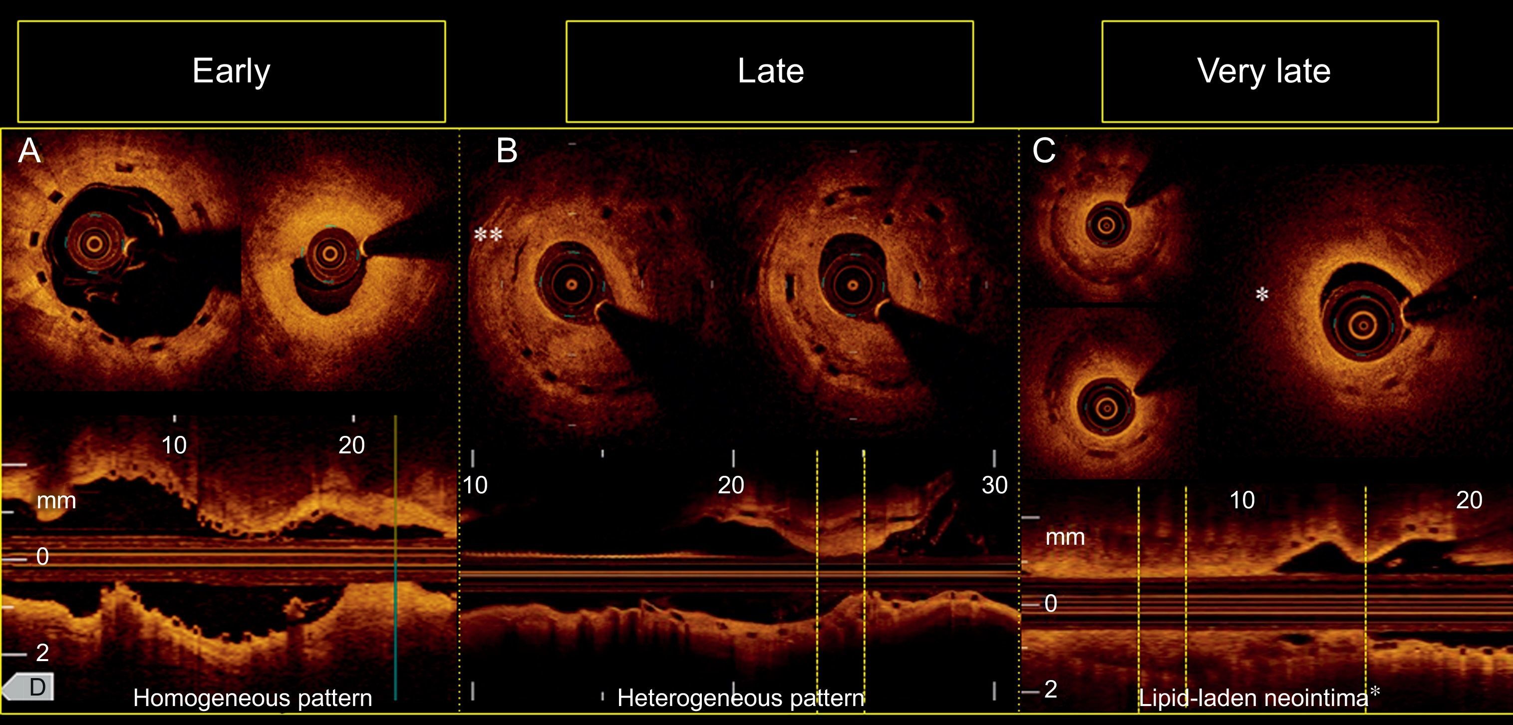 Restenosis After Everolimus-eluting Vascular Scaffolding. Angiographic ...