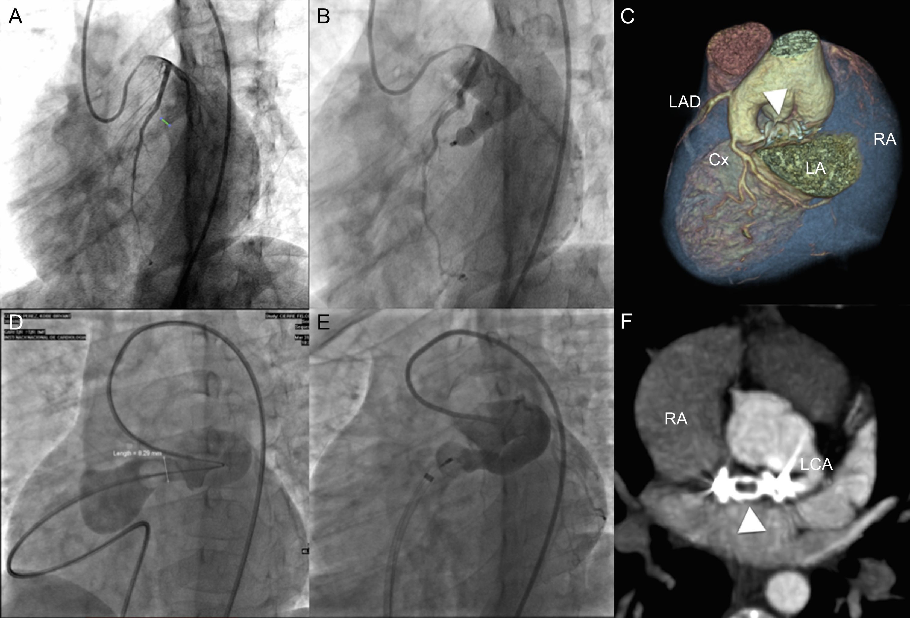 Percutaneous Closure of Complex Fistulas Between the Left Main Coronary ...