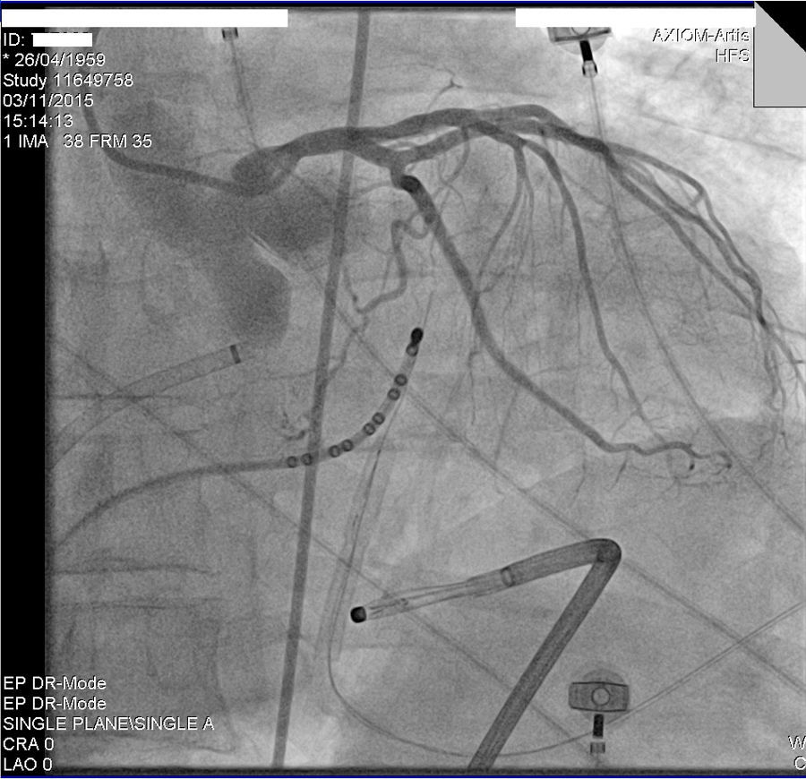 Endoepicardial Ventricular Tachycardia Ablation With a New High-density ...