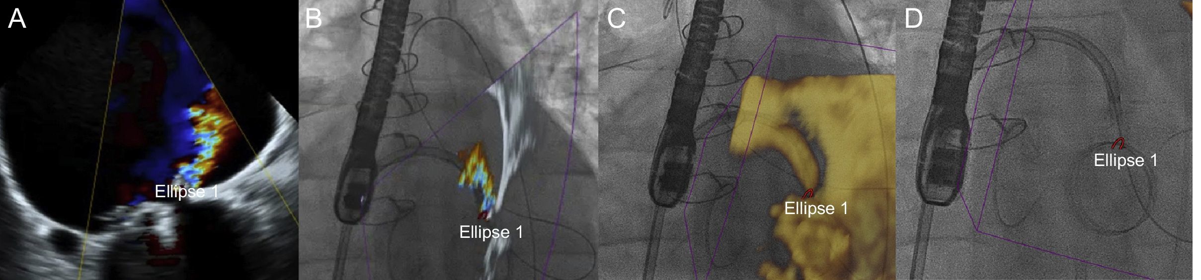 Echo-X Ray Fusion in Paravalvular Leak Closure | Revista Española de ...