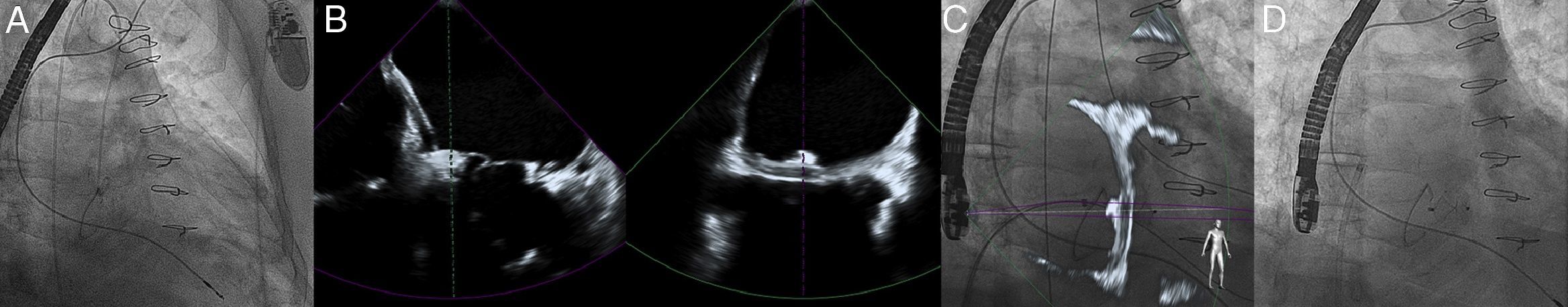 Echo-X Ray Fusion in Paravalvular Leak Closure | Revista Española de ...