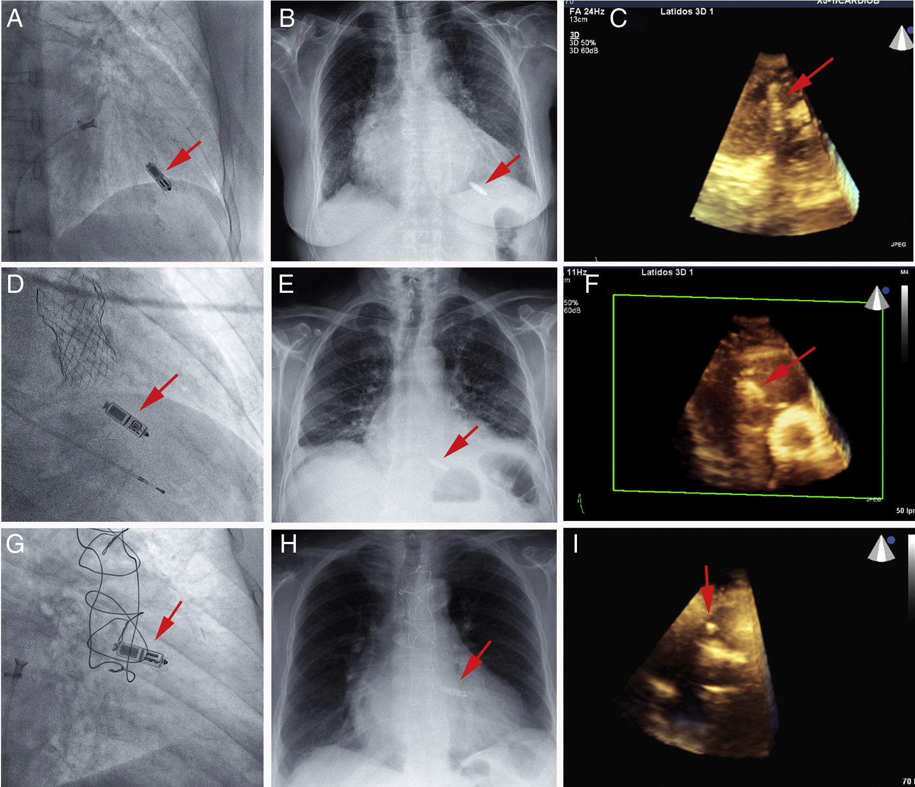 Usefulness of Three-dimensional Transthoracic Echocardiograhy in the ...