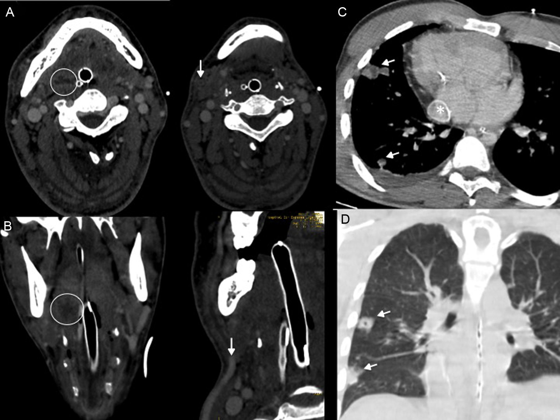 Lemierre Syndrome in an Adult Patient With Fontan Circulation | Revista ...