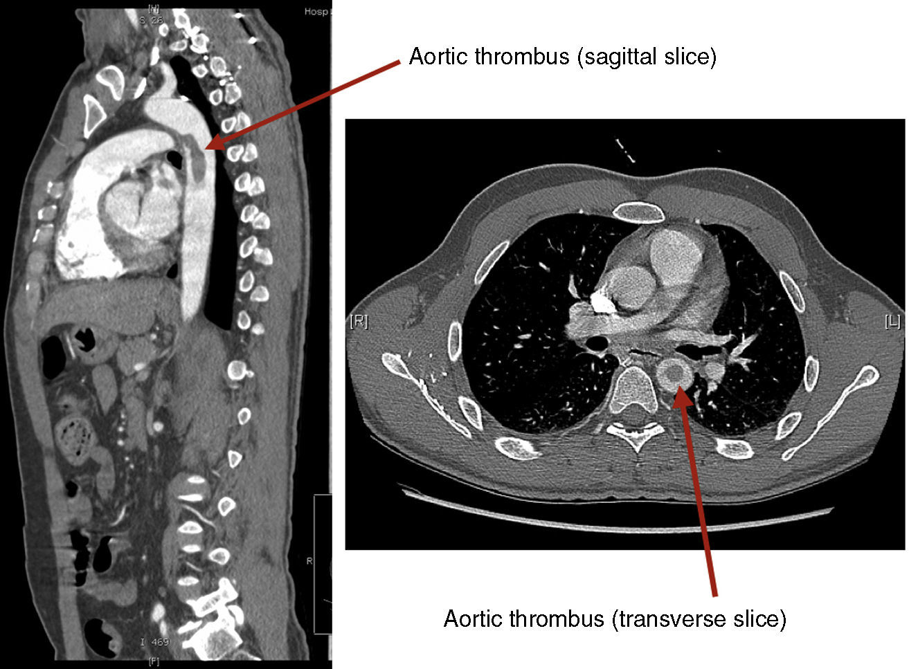 Systemic Emboli: The Importance of Transesophageal Echocardiography