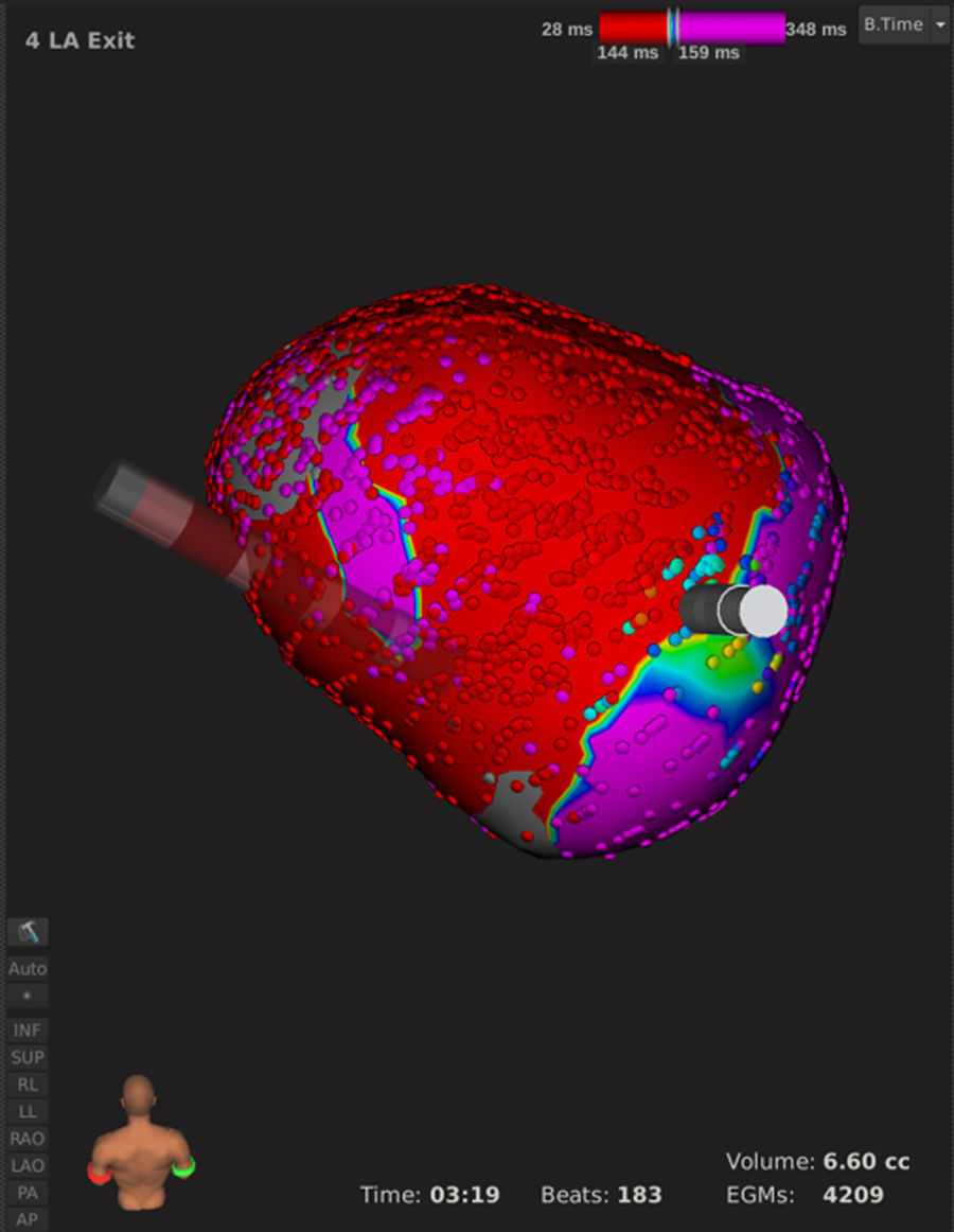Atrial Fibrillation Ablation Guided by a Novel Nonfluoroscopic ...