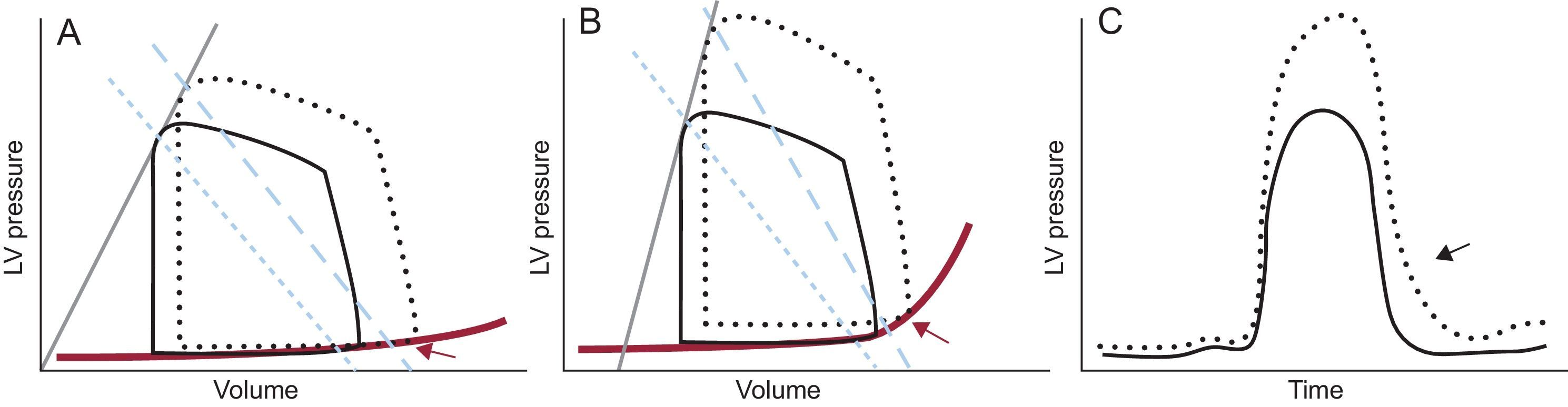 Diagnostic and Prognostic Value of CMR T1-Mapping in Patients With ...