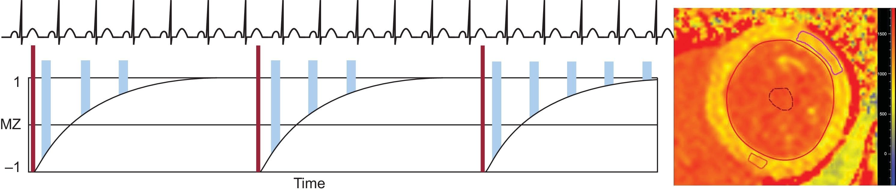 Diagnostic and Prognostic Value of CMR T1-Mapping in Patients With ...