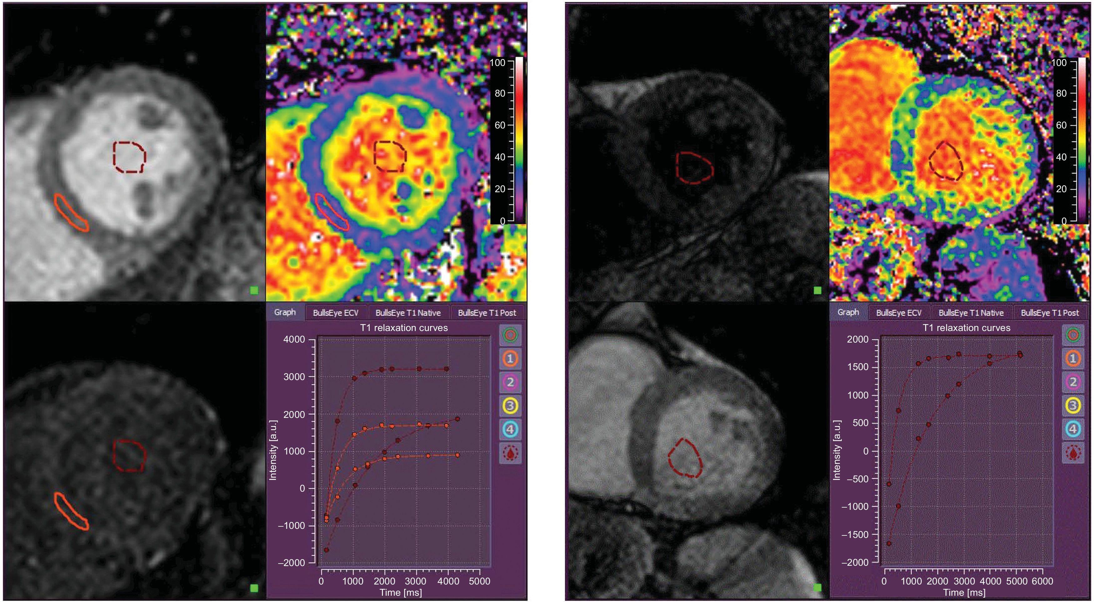 Diagnostic and Prognostic Value of CMR T1-Mapping in Patients With ...