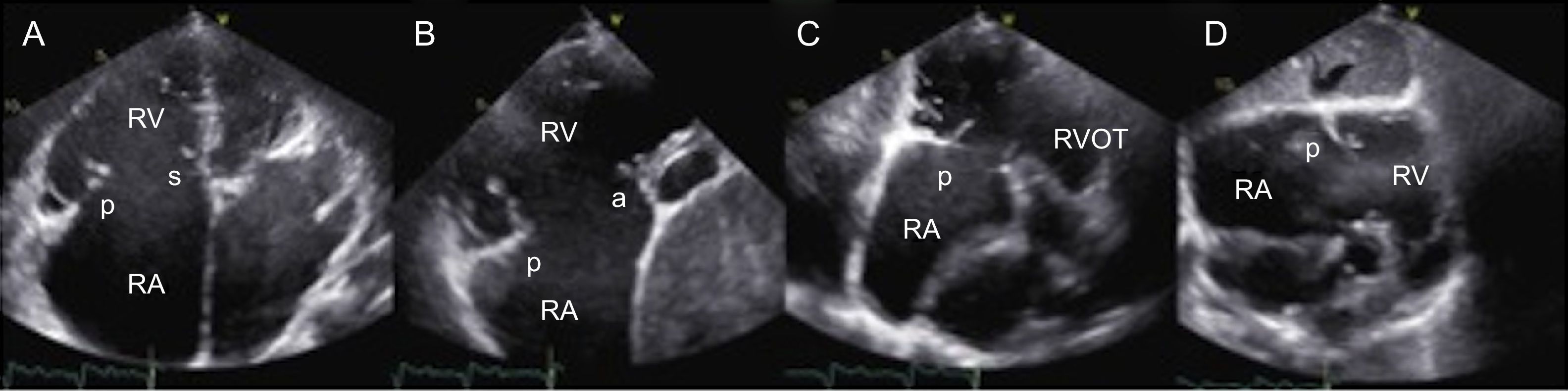 Percutaneous Treatment of the Tricuspid Valve Disease: New Hope for the ...