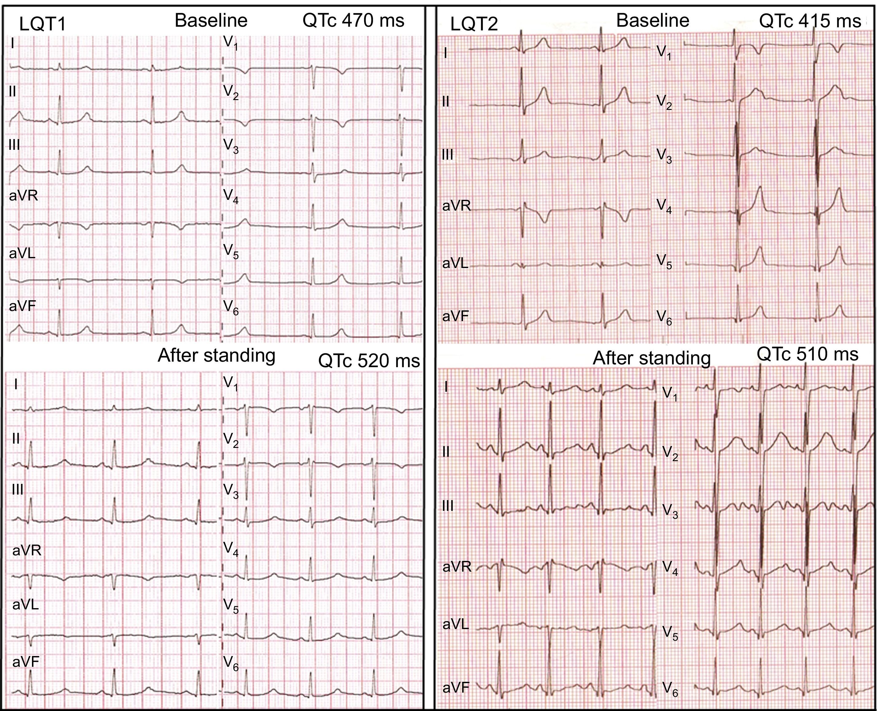 Value of the “Standing Test” in the Diagnosis and Evaluation of Beta ...